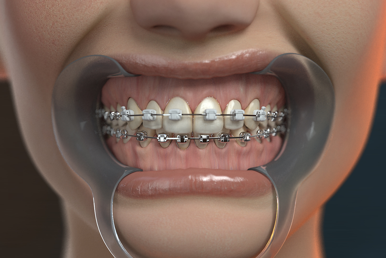 3D Model Orthodontic Mannequin V-ray Ortho - TurboSquid 1338305