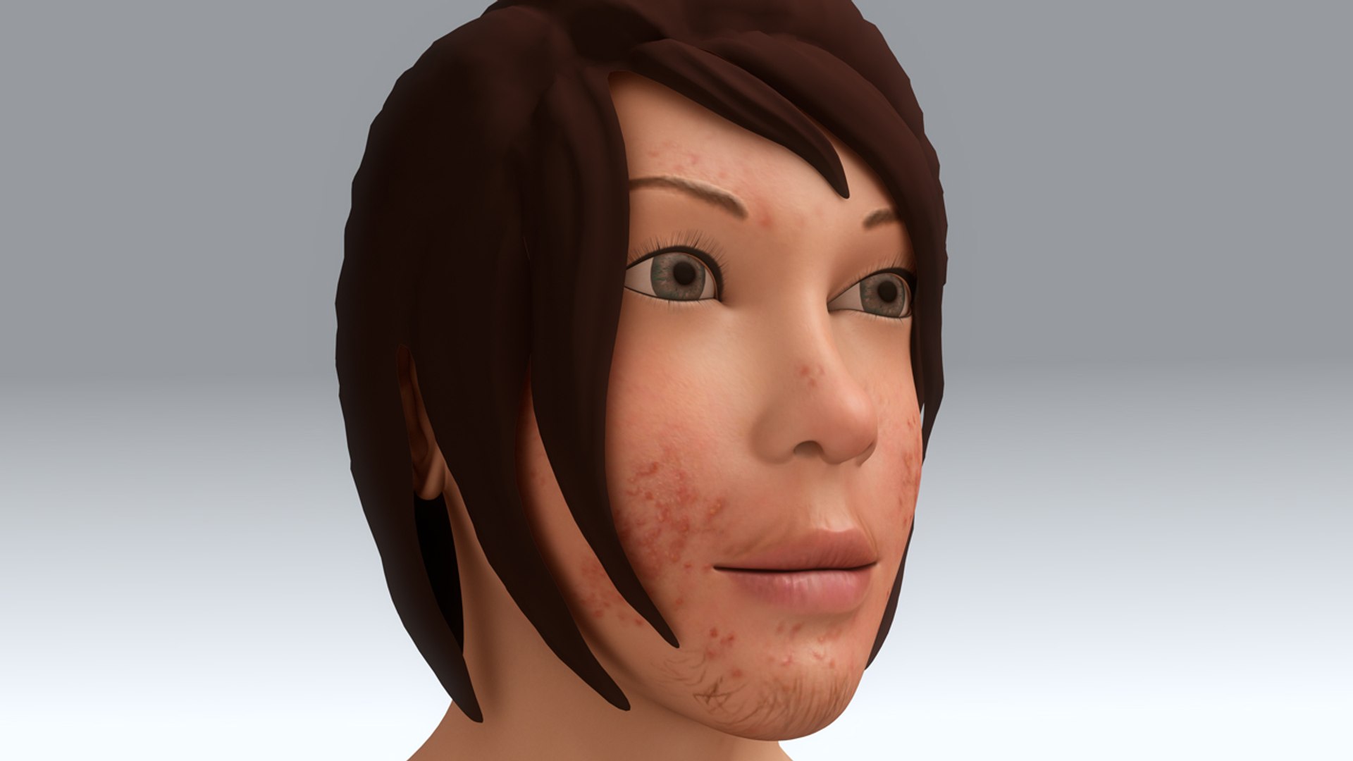 Female Pimples 3d Obj