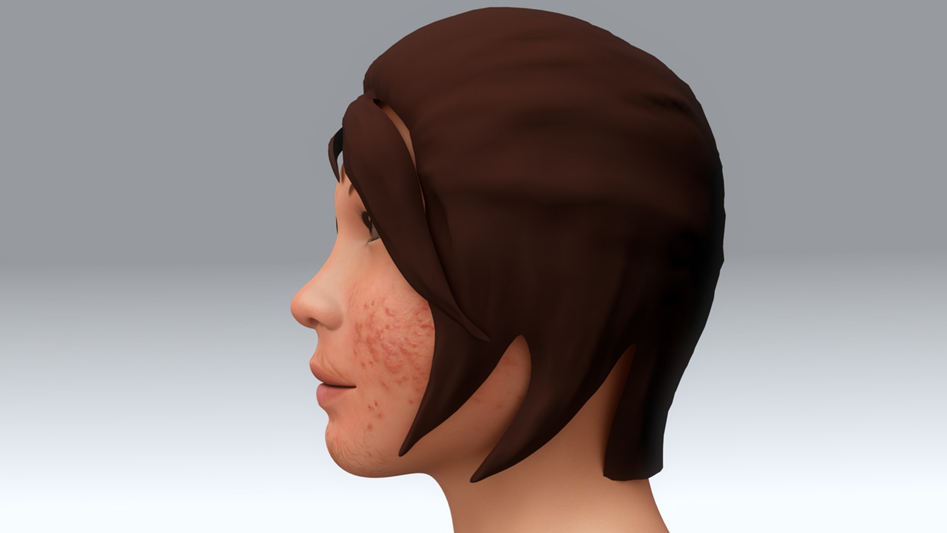 Female Pimples 3d Obj