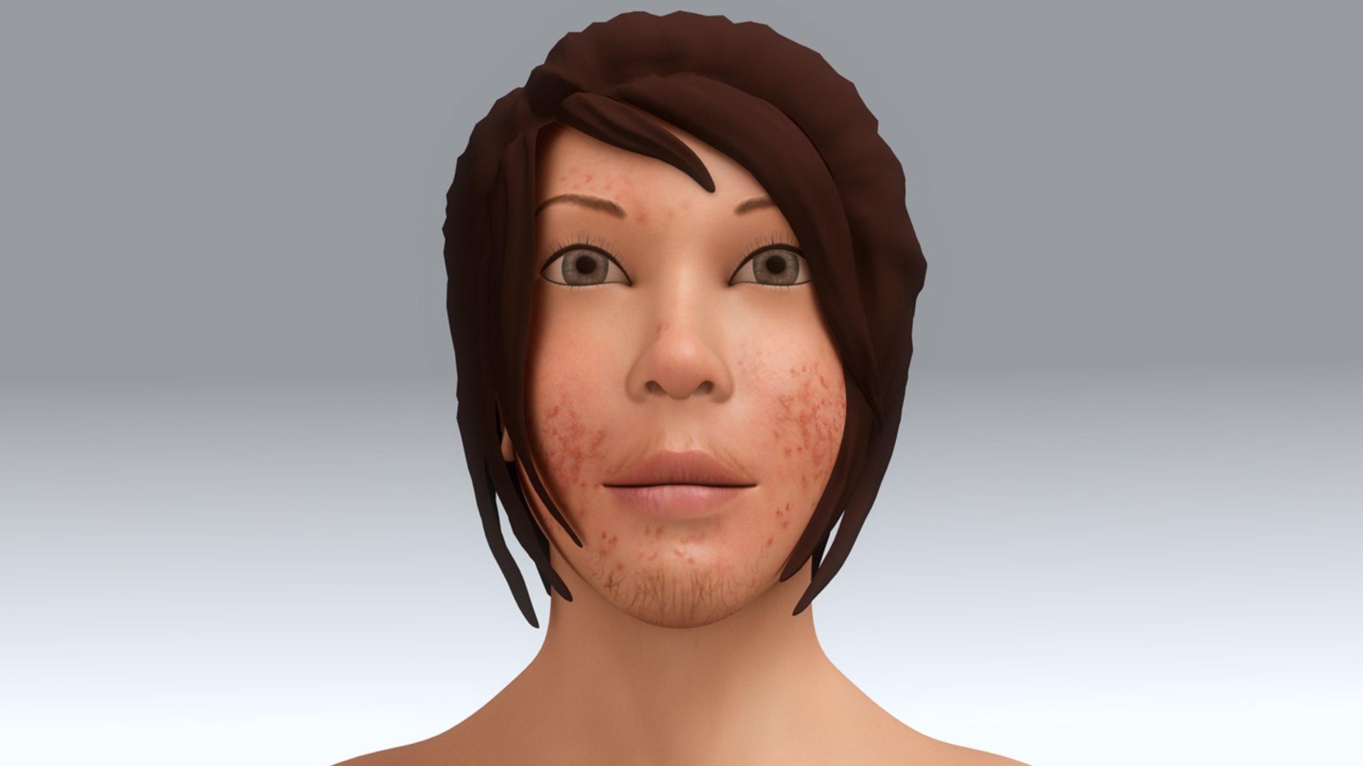 Female Pimples 3d Obj