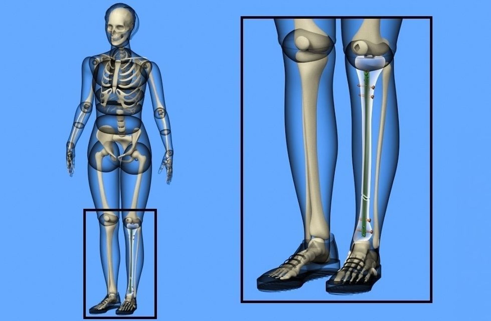 Tibial Nails 3D - TurboSquid 1578036