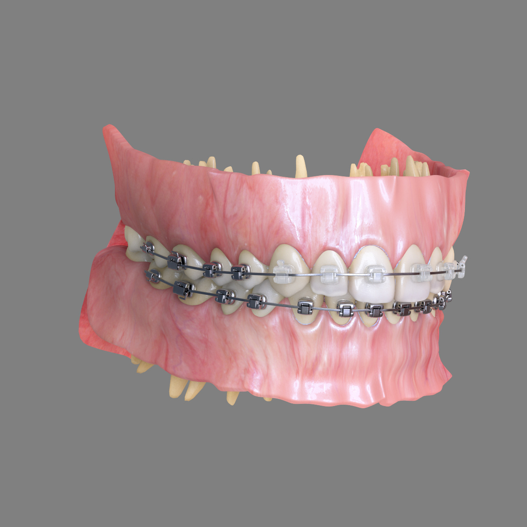 Realistic Dentition Braces 3d Max
