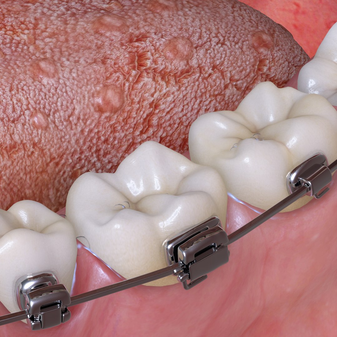 Realistic Dentition Braces 3d Max