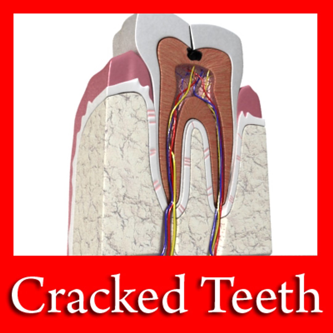 Cracked Teeth 3ds