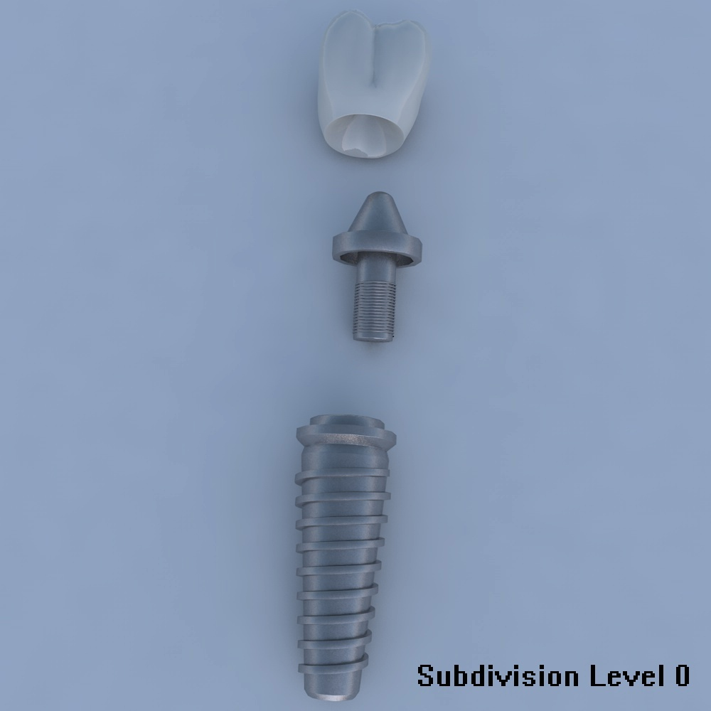Dental implant 3D model - TurboSquid 1213056