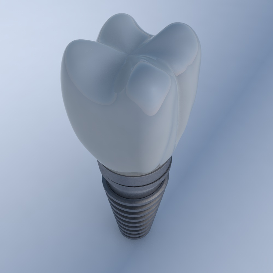 Dental implant 3D model - TurboSquid 1213056