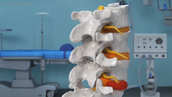3D Spinal Column with Hernia - TurboSquid 2051010
