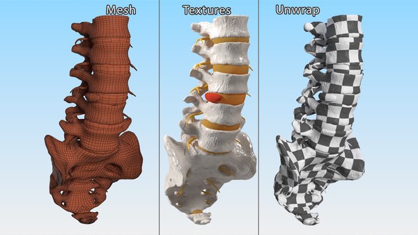 3D Spinal Column with Hernia - TurboSquid 2051010
