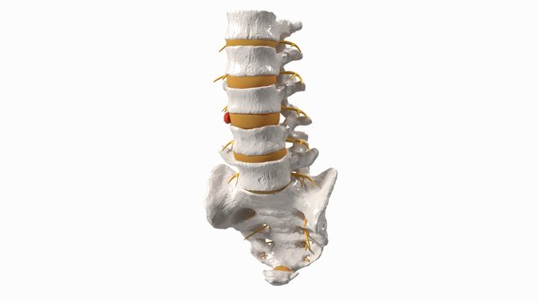 3D Spinal Column with Hernia - TurboSquid 2051010