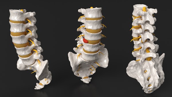 3D Spinal Column with Hernia - TurboSquid 2051010
