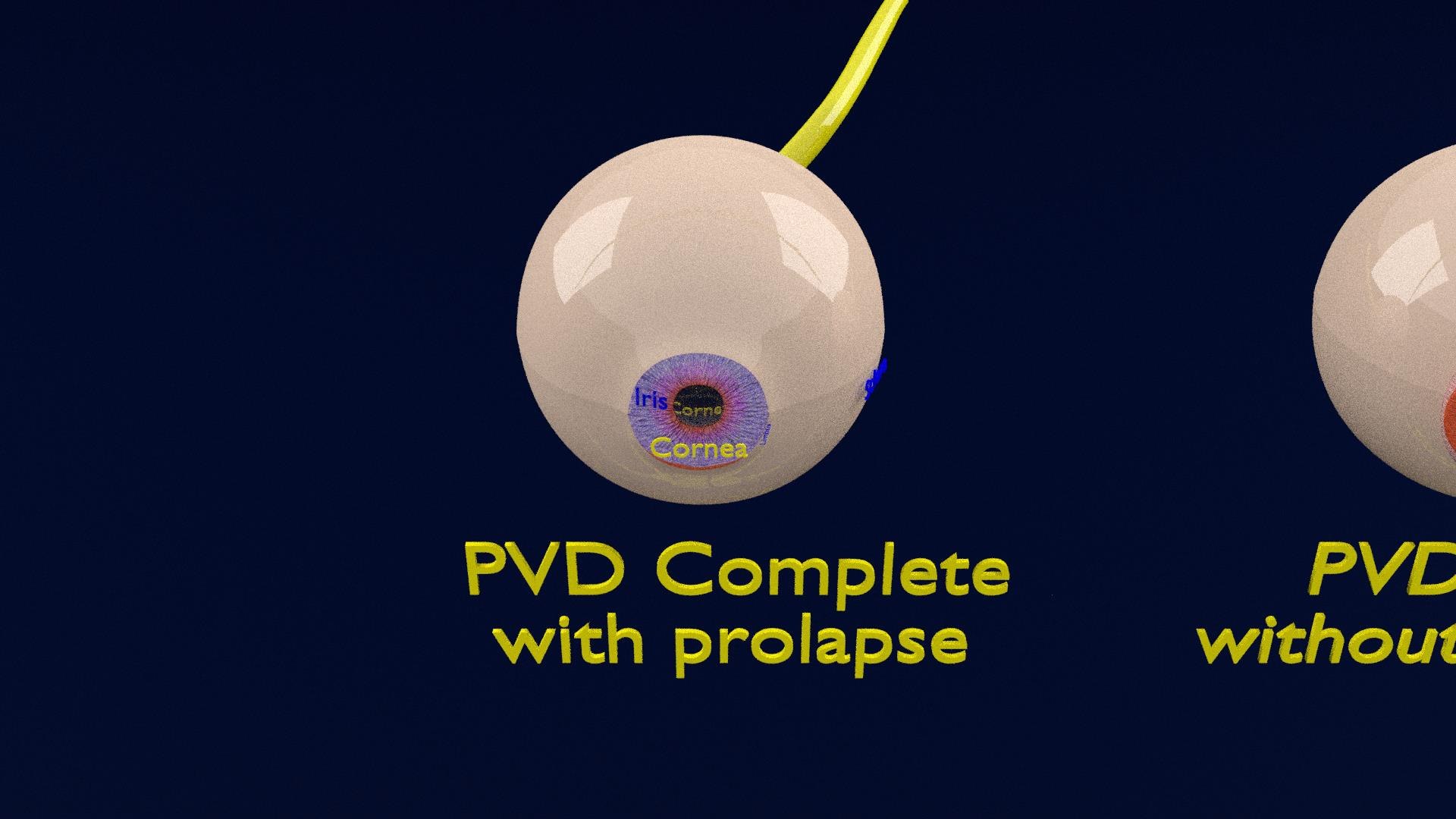 3D Posterior Vitreous Detachment Types Eye - TurboSquid 1775274