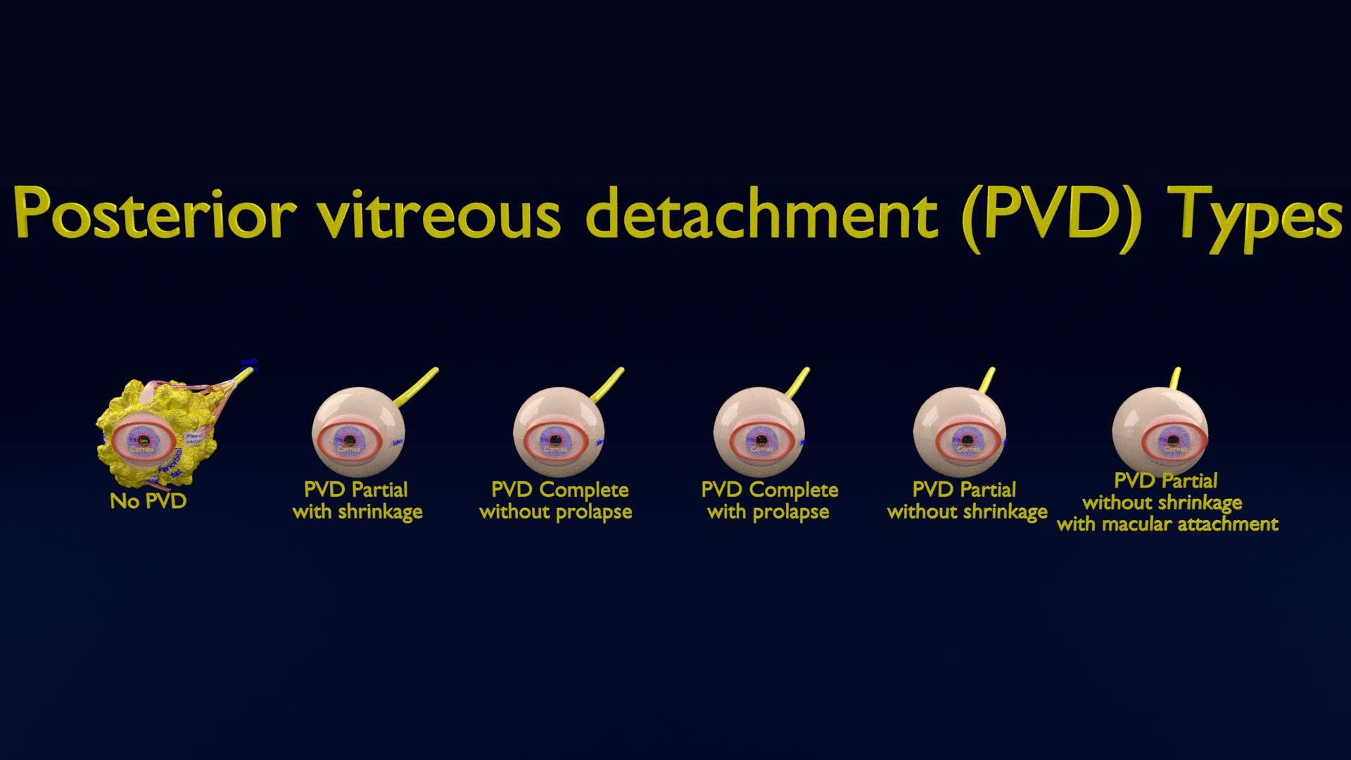 3D Posterior Vitreous Detachment Types Eye - TurboSquid 1775274