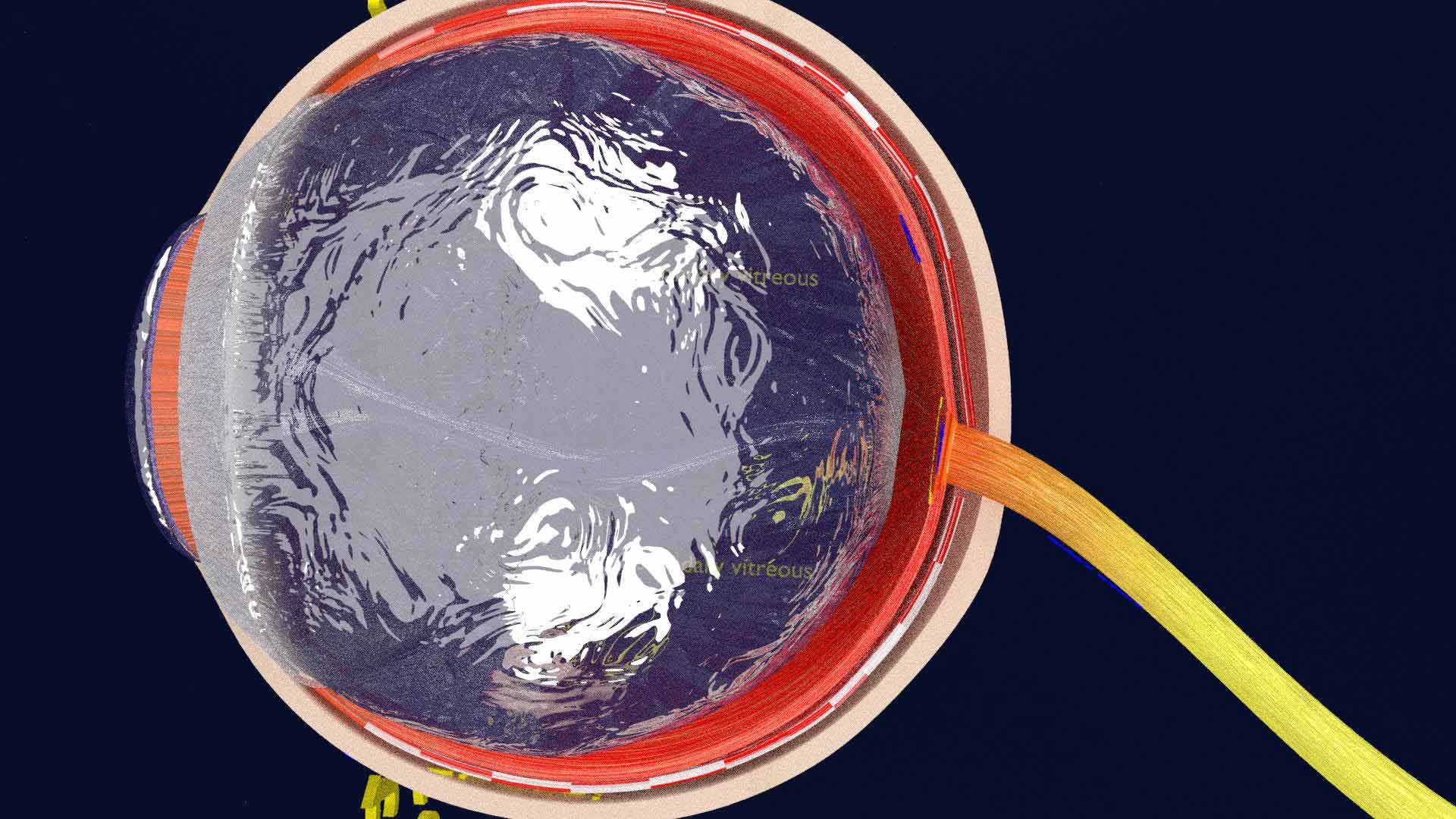 3D Posterior Vitreous Detachment Types Eye - TurboSquid 1775274