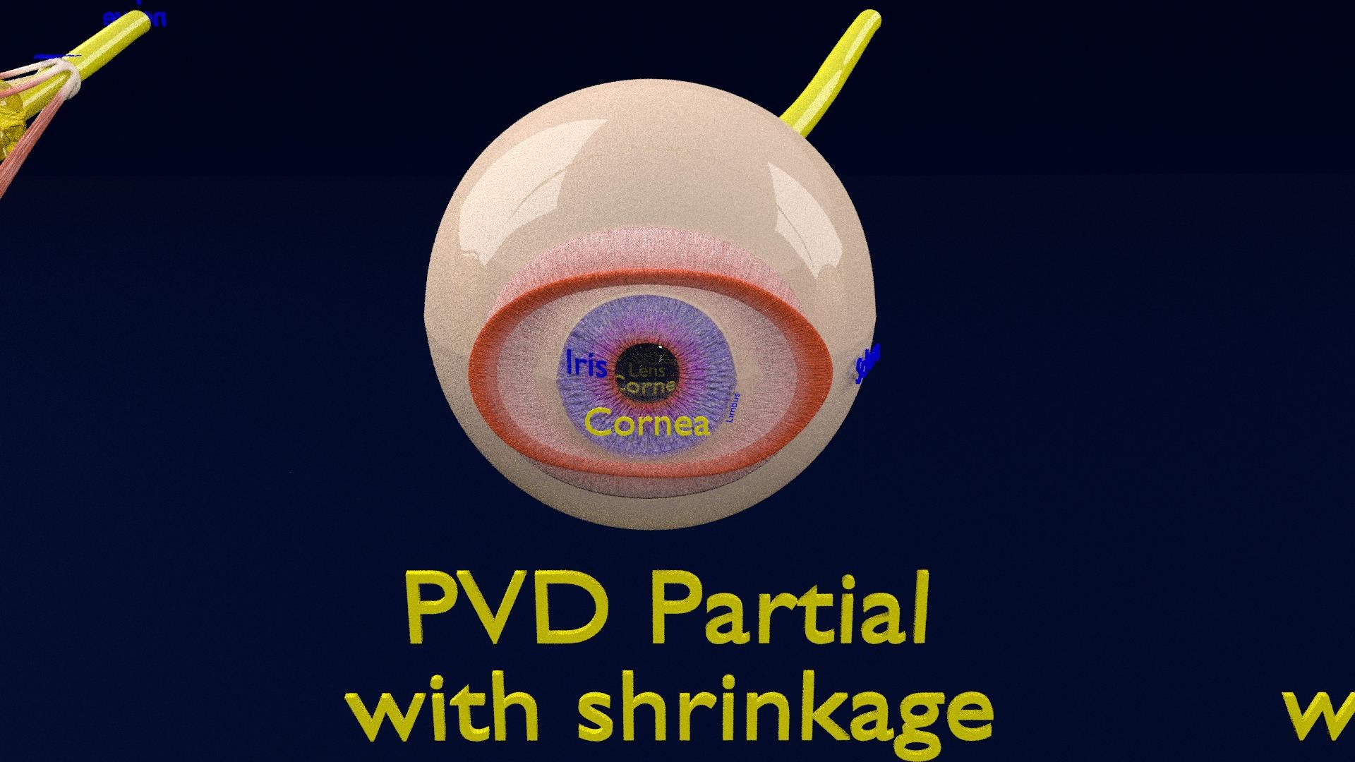 3D Posterior Vitreous Detachment Types Eye - TurboSquid 1775274