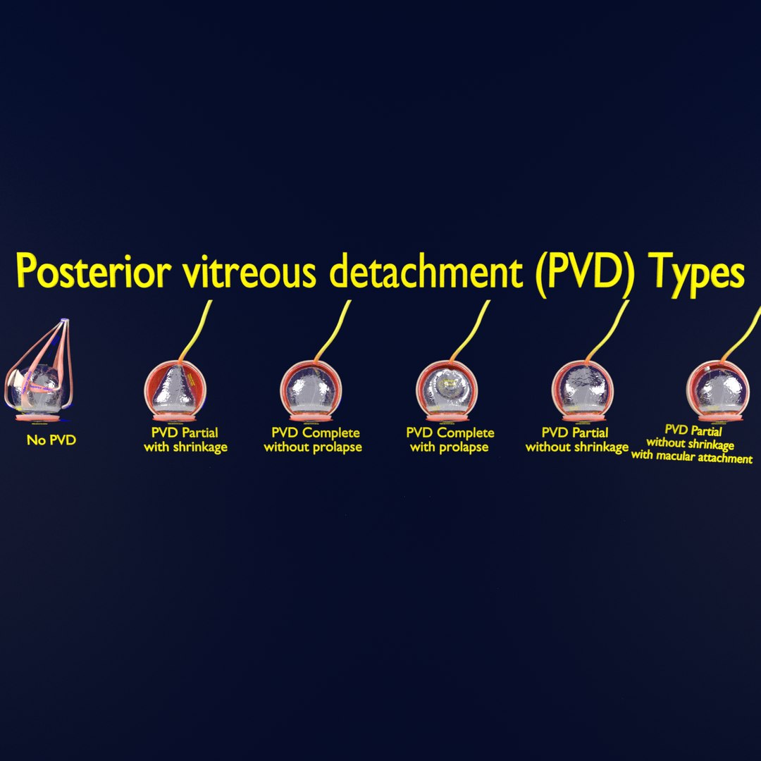 3D Posterior vitreous detachment types eye - TurboSquid 1775274
