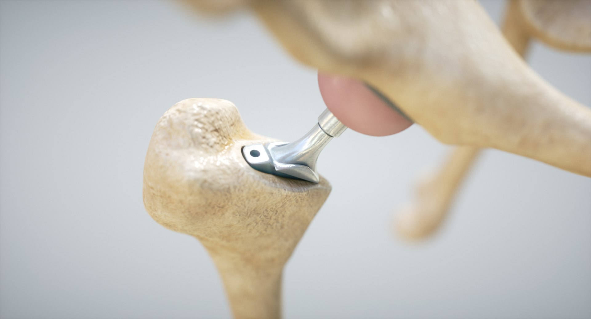 Medical Endoprosthesis 3d Model
