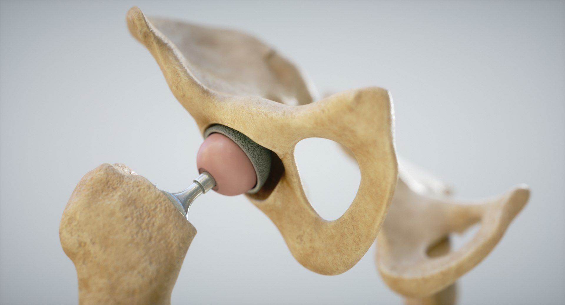 Medical Endoprosthesis 3d Model