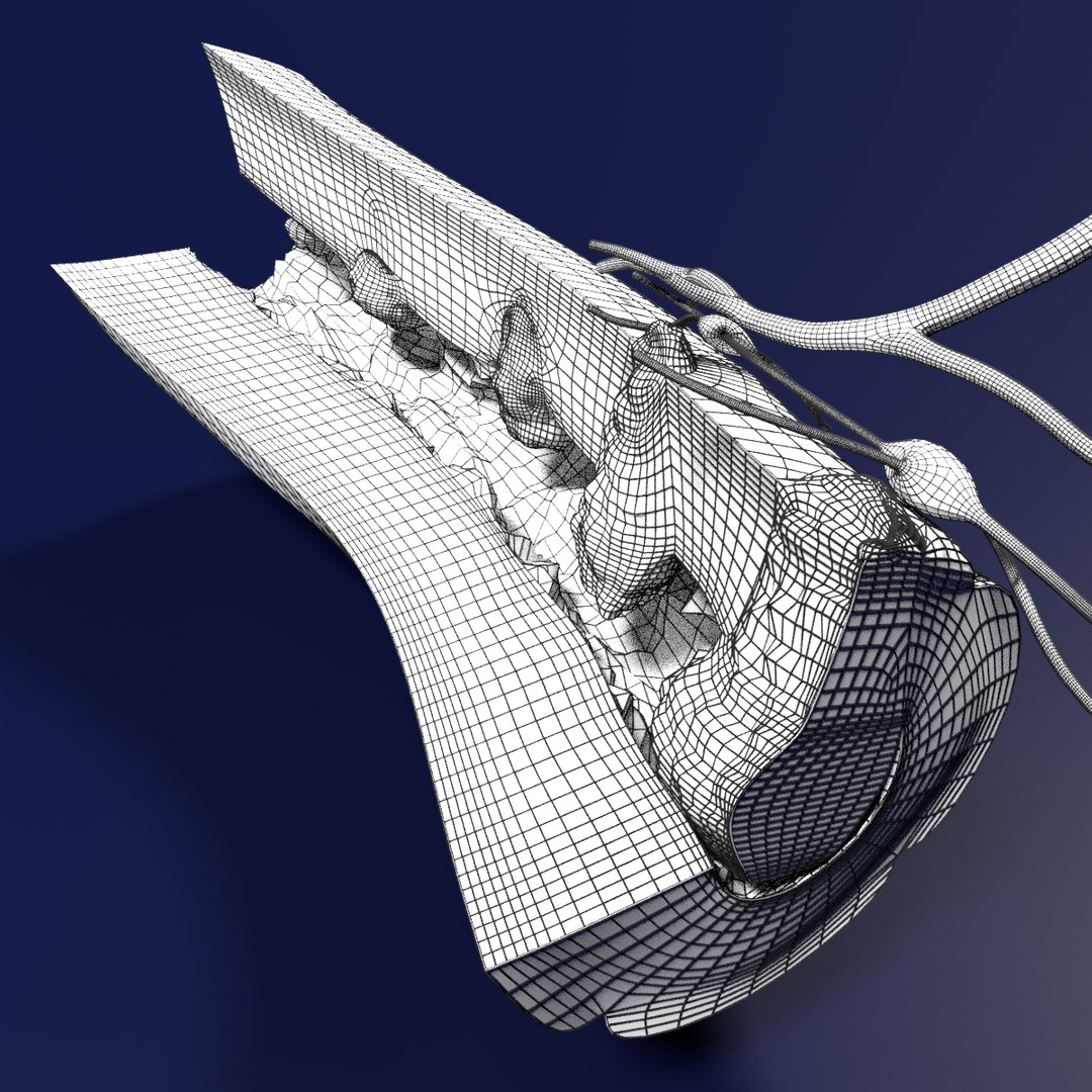 3D Colon Cancer Staging - TurboSquid 1480137