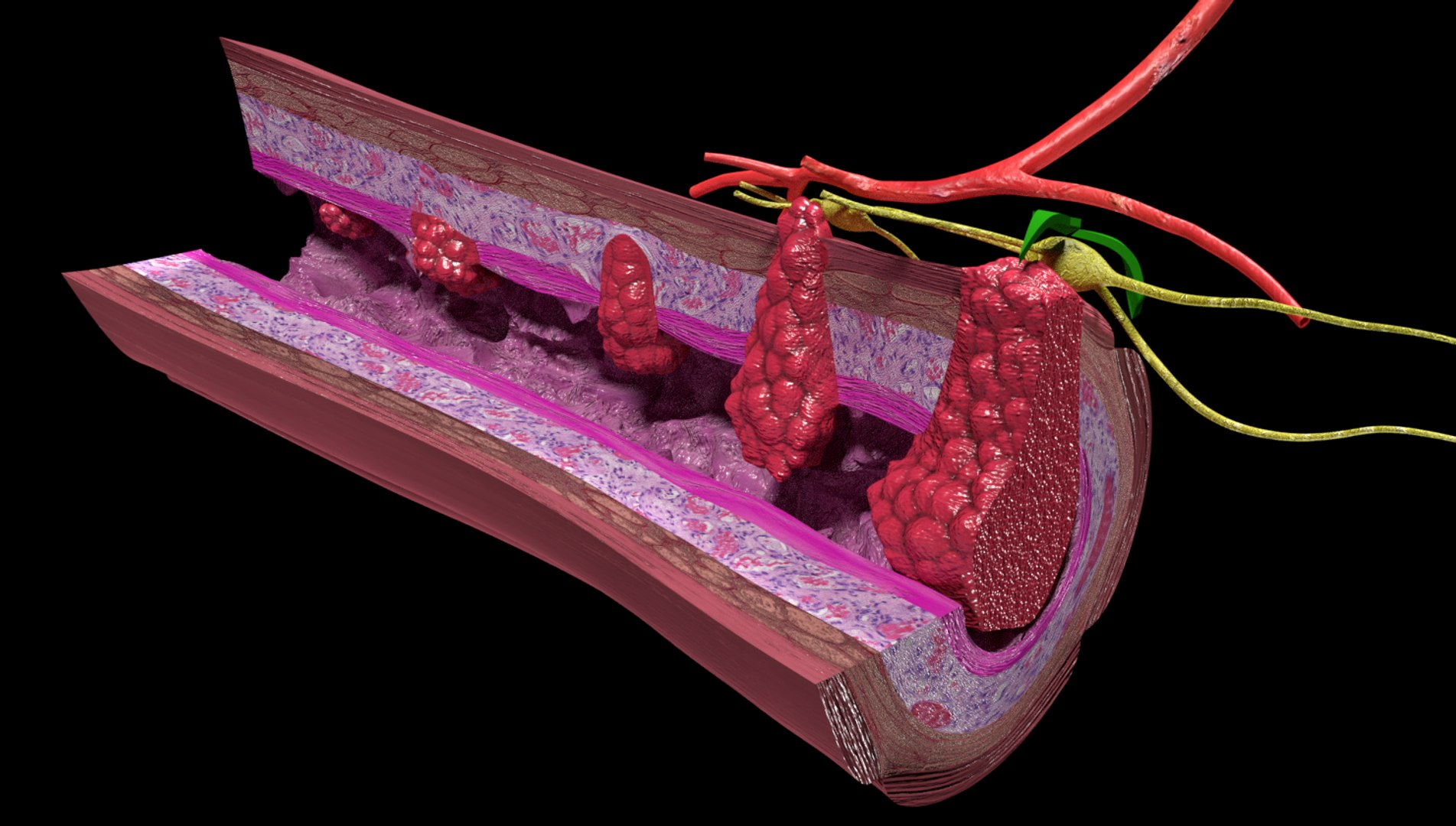 3D Colon Cancer Staging - TurboSquid 1480137