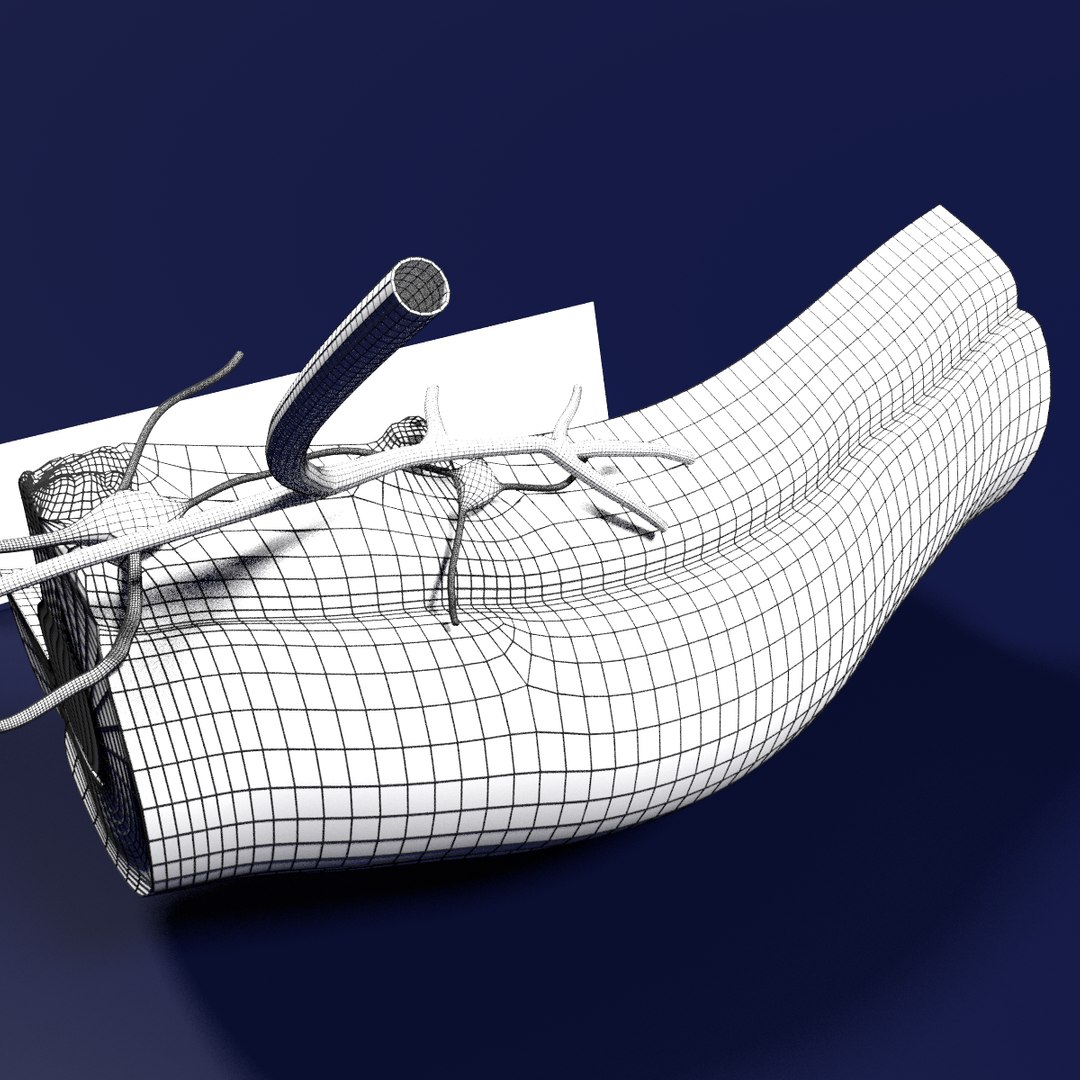 3D Colon Cancer Staging - TurboSquid 1480137