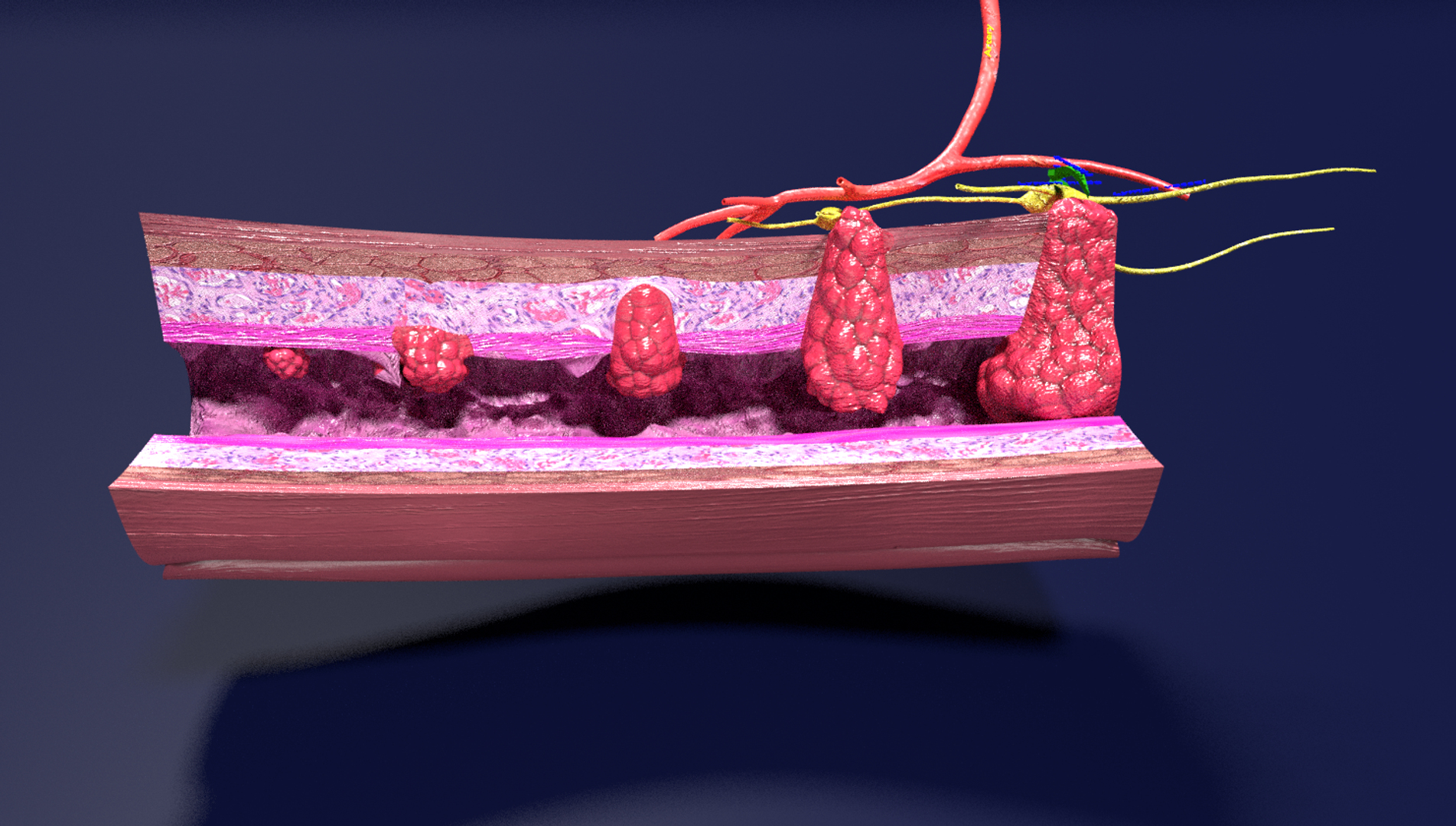 3D Colon Cancer Staging - TurboSquid 1480137