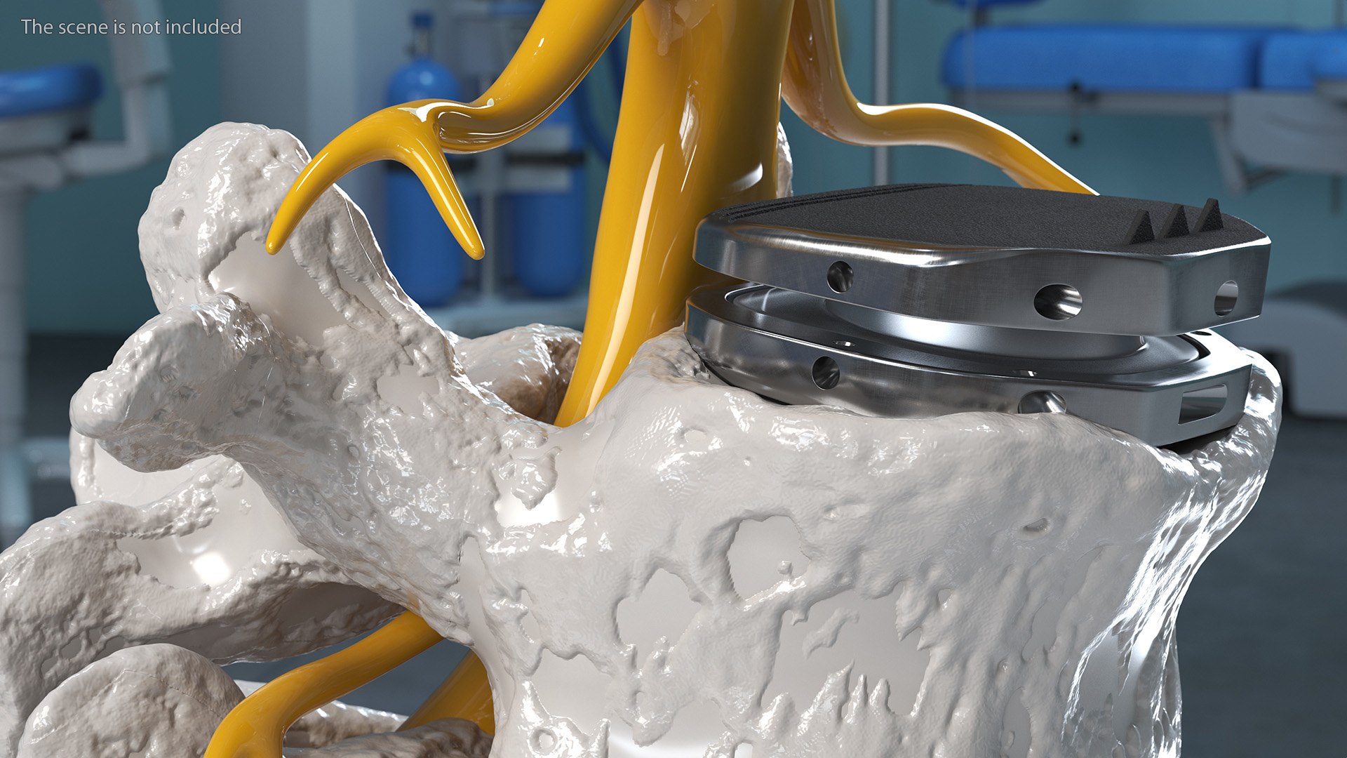 Spinal Lumbar Disc Prosthesis Implant 3D - TurboSquid 2205564