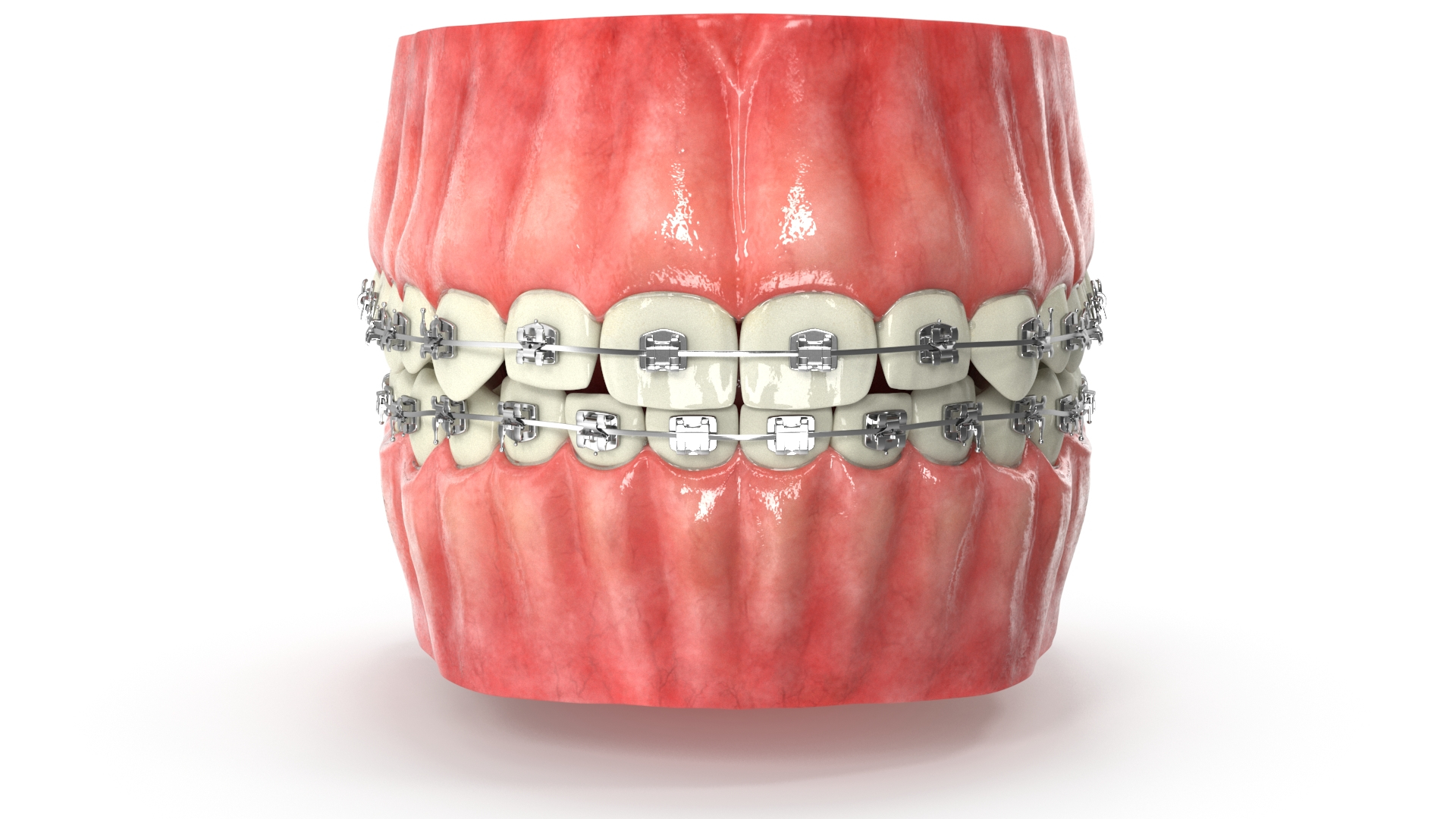 3D Model Human Mouth With Self Ligating Steel Dental Braces V03 ...