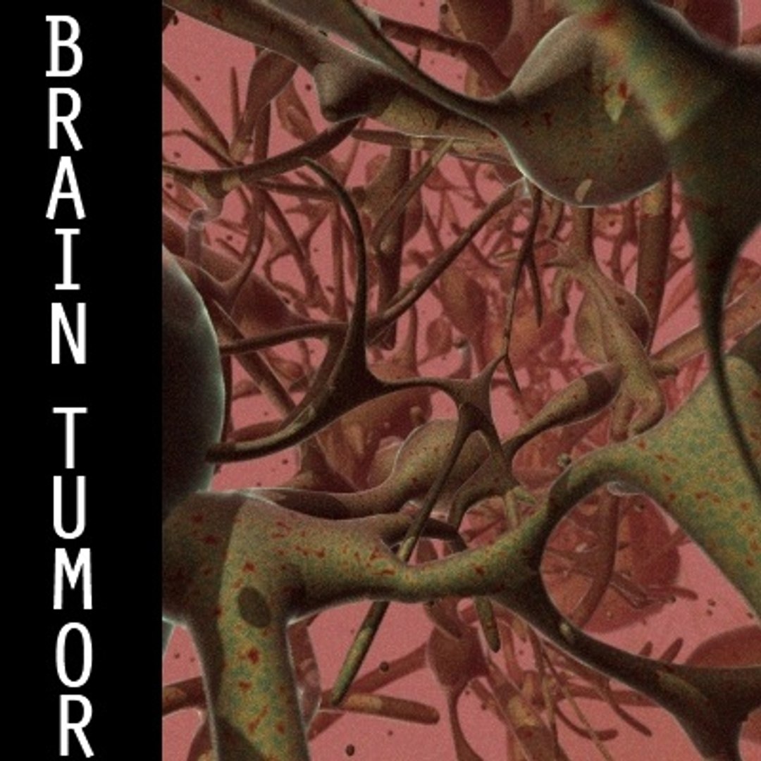 Brain Tumor 3d Model