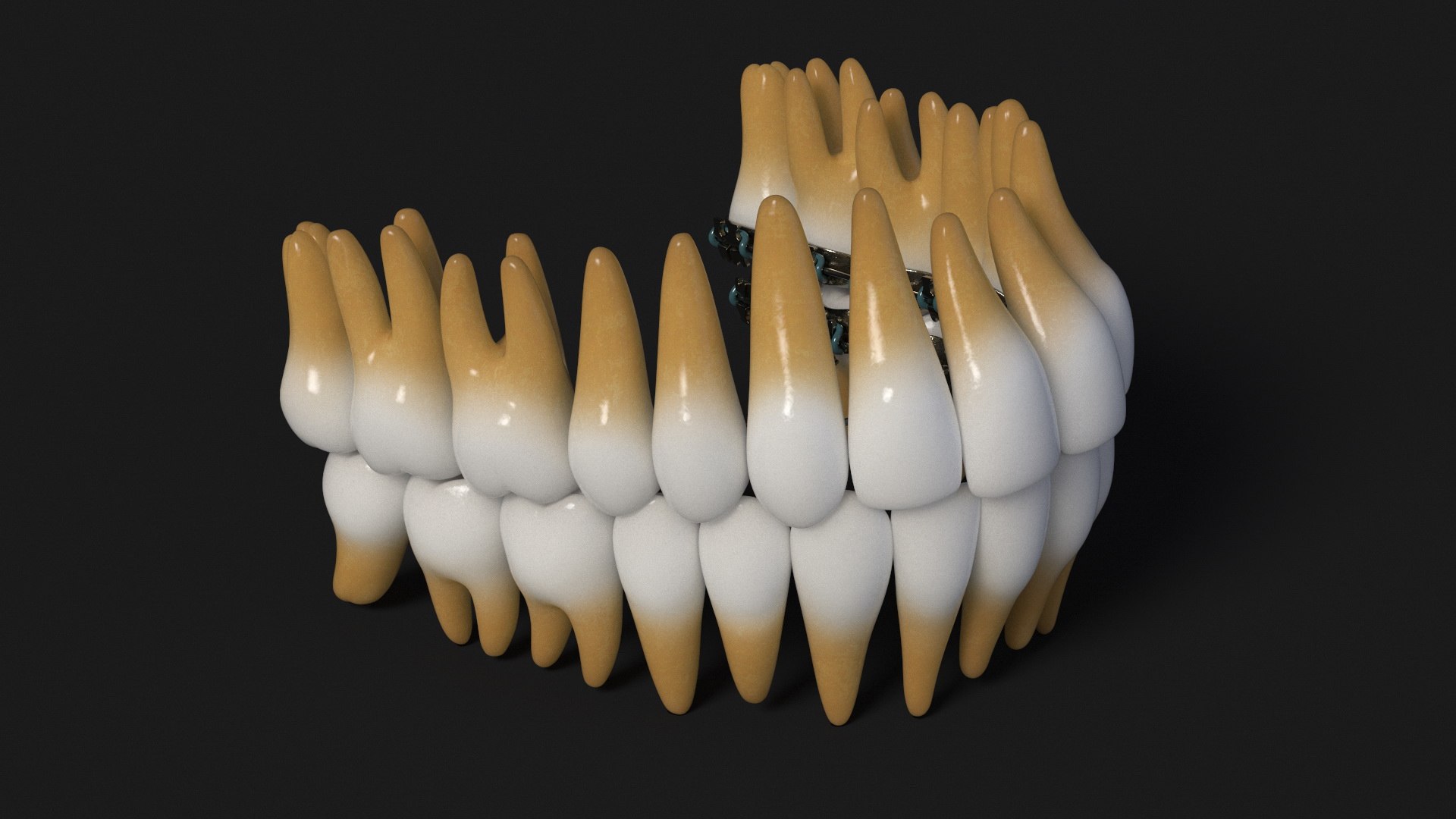 Dental Typodonts With Bracket Collection 3D Model - TurboSquid 2346556