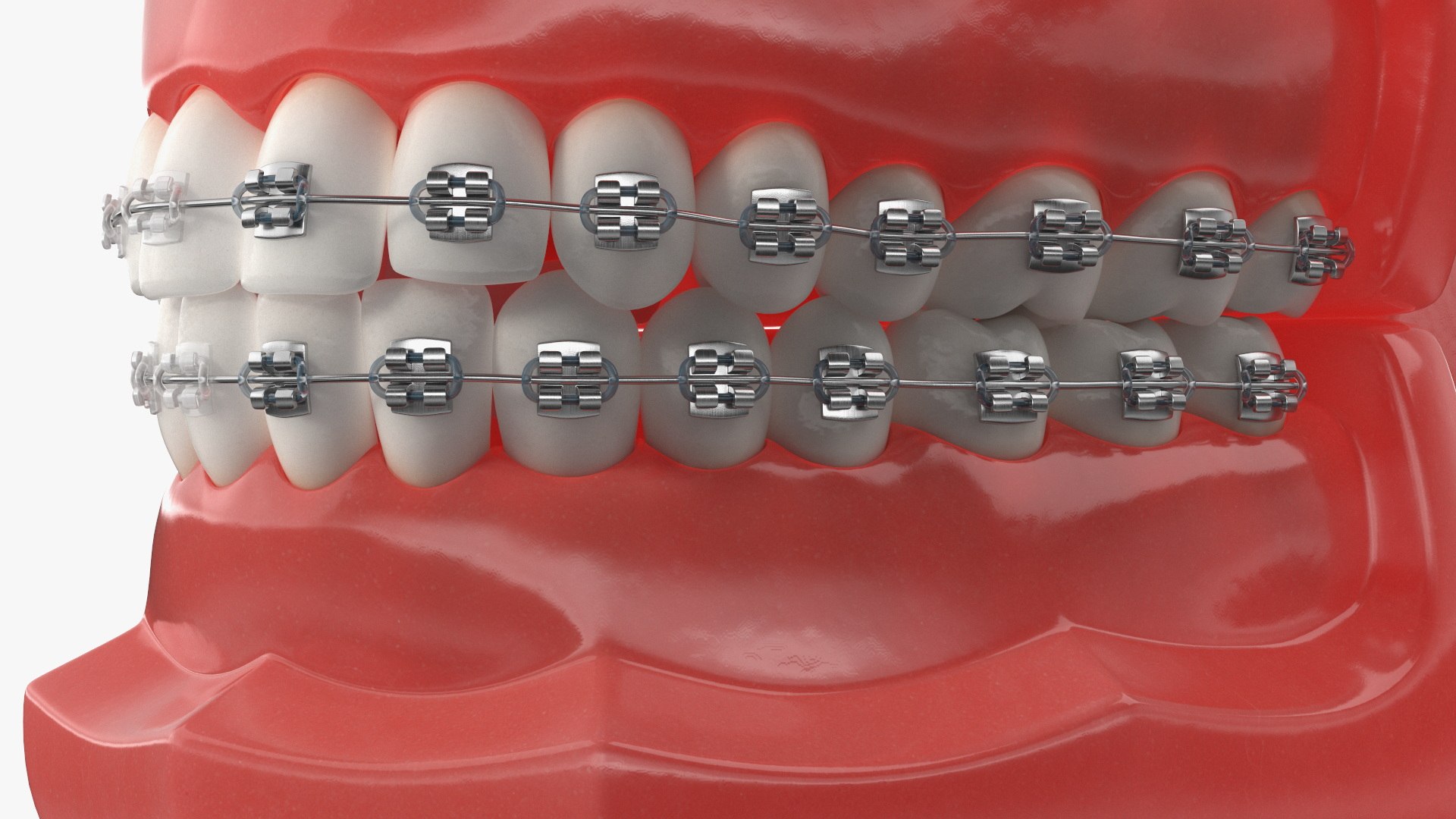 Dental Typodonts With Bracket Collection 3D Model - TurboSquid 2346556