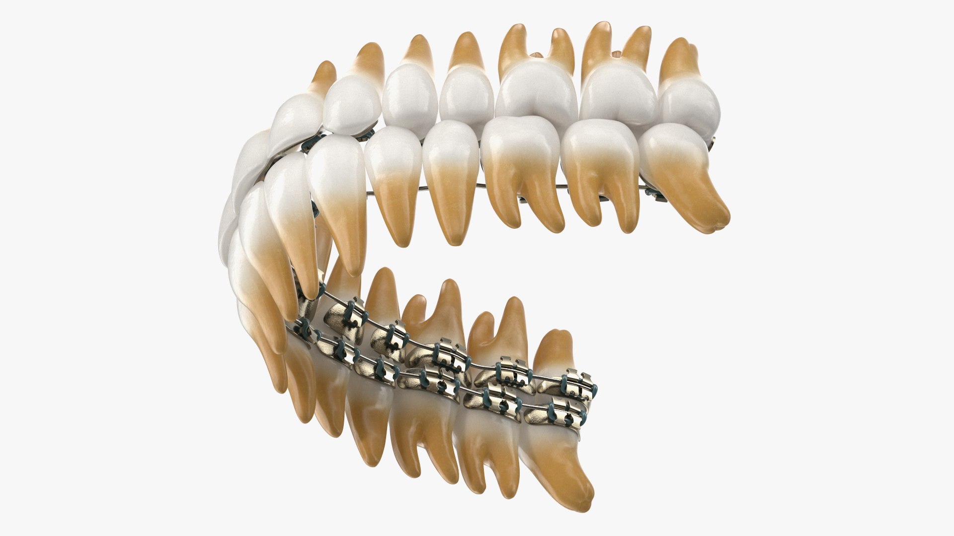 Dental Typodonts With Bracket Collection 3D Model - TurboSquid 2346556