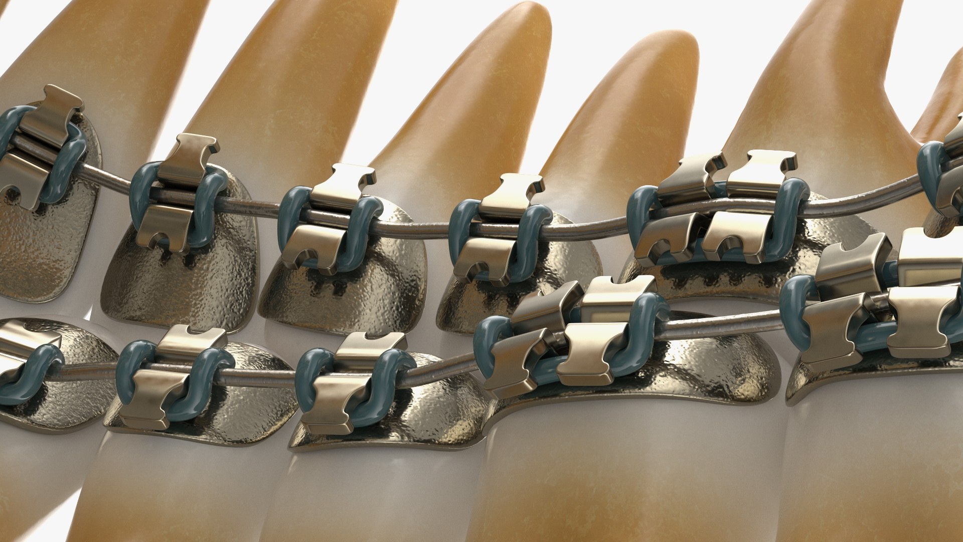 Dental Typodonts With Bracket Collection 3D Model - TurboSquid 2346556