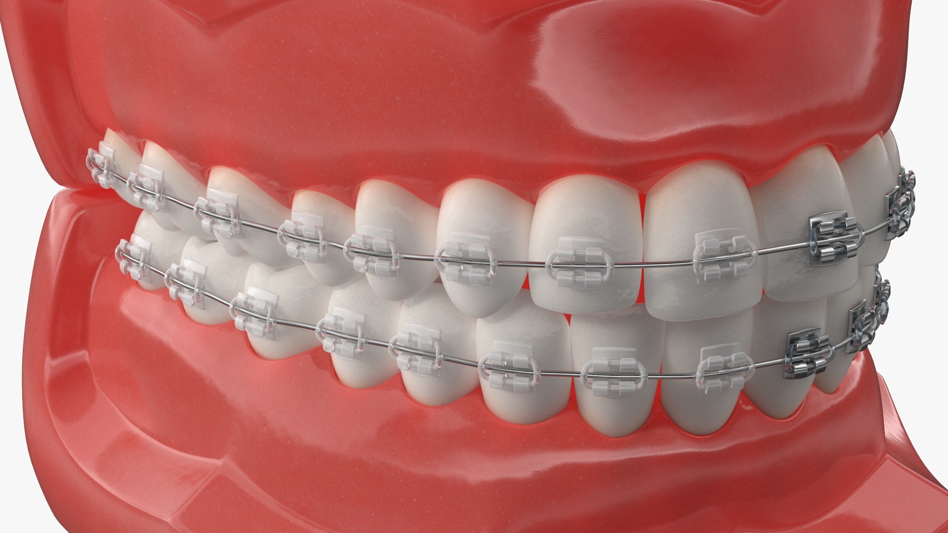Dental Typodonts With Bracket Collection 3D Model - TurboSquid 2346556