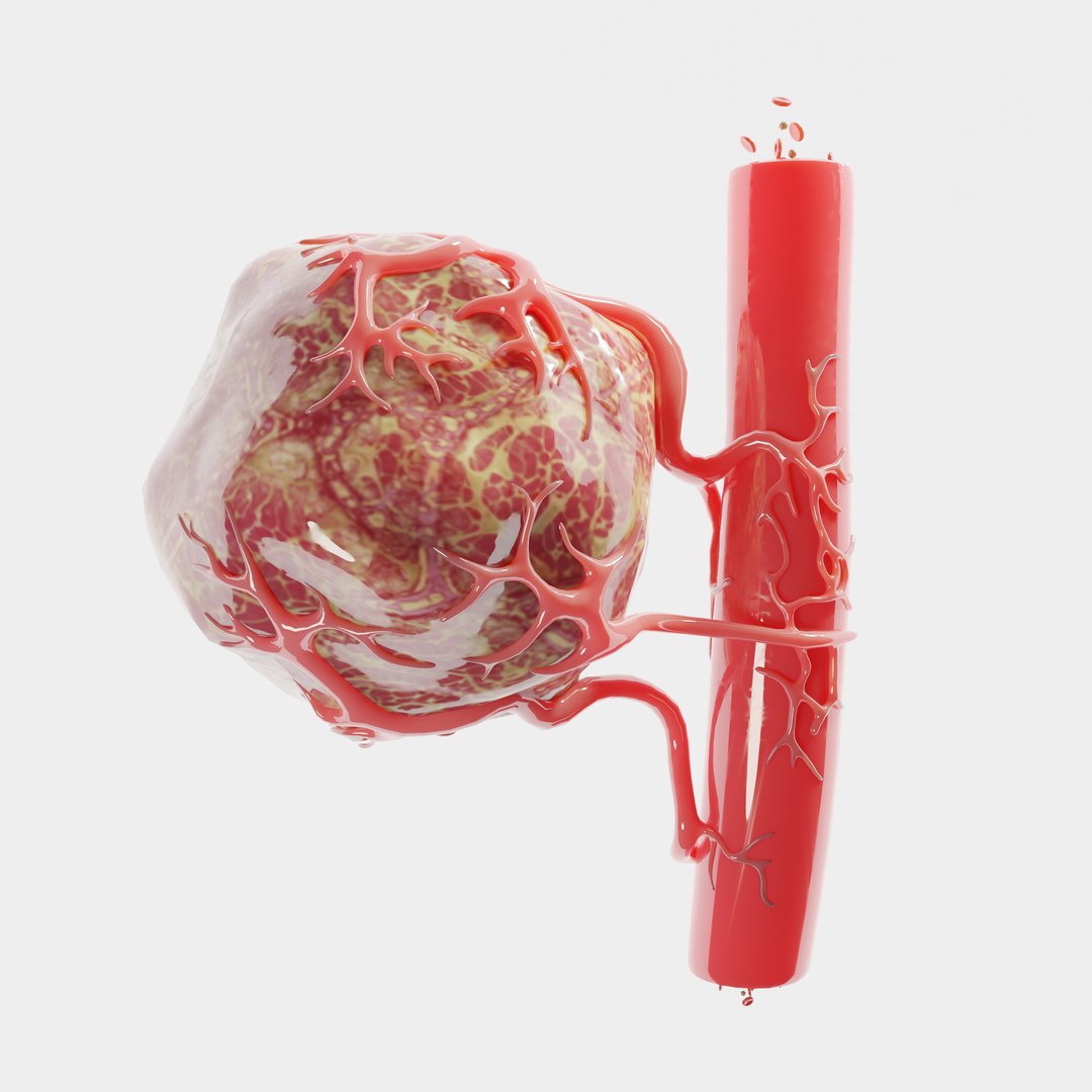Vessel tumor 3D model - TurboSquid 1659263