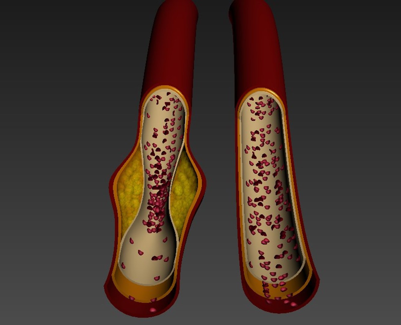 3D Model Blood Vessel Normal Damages - TurboSquid 1243108