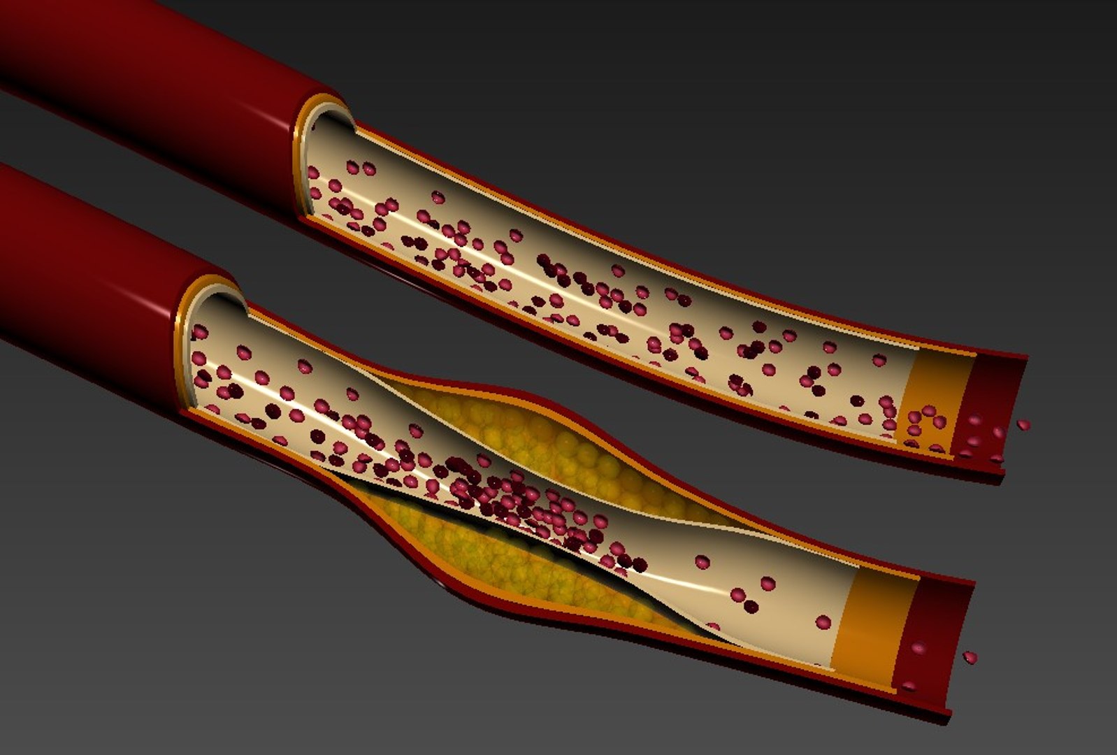 3D Model Blood Vessel Normal Damages - TurboSquid 1243108
