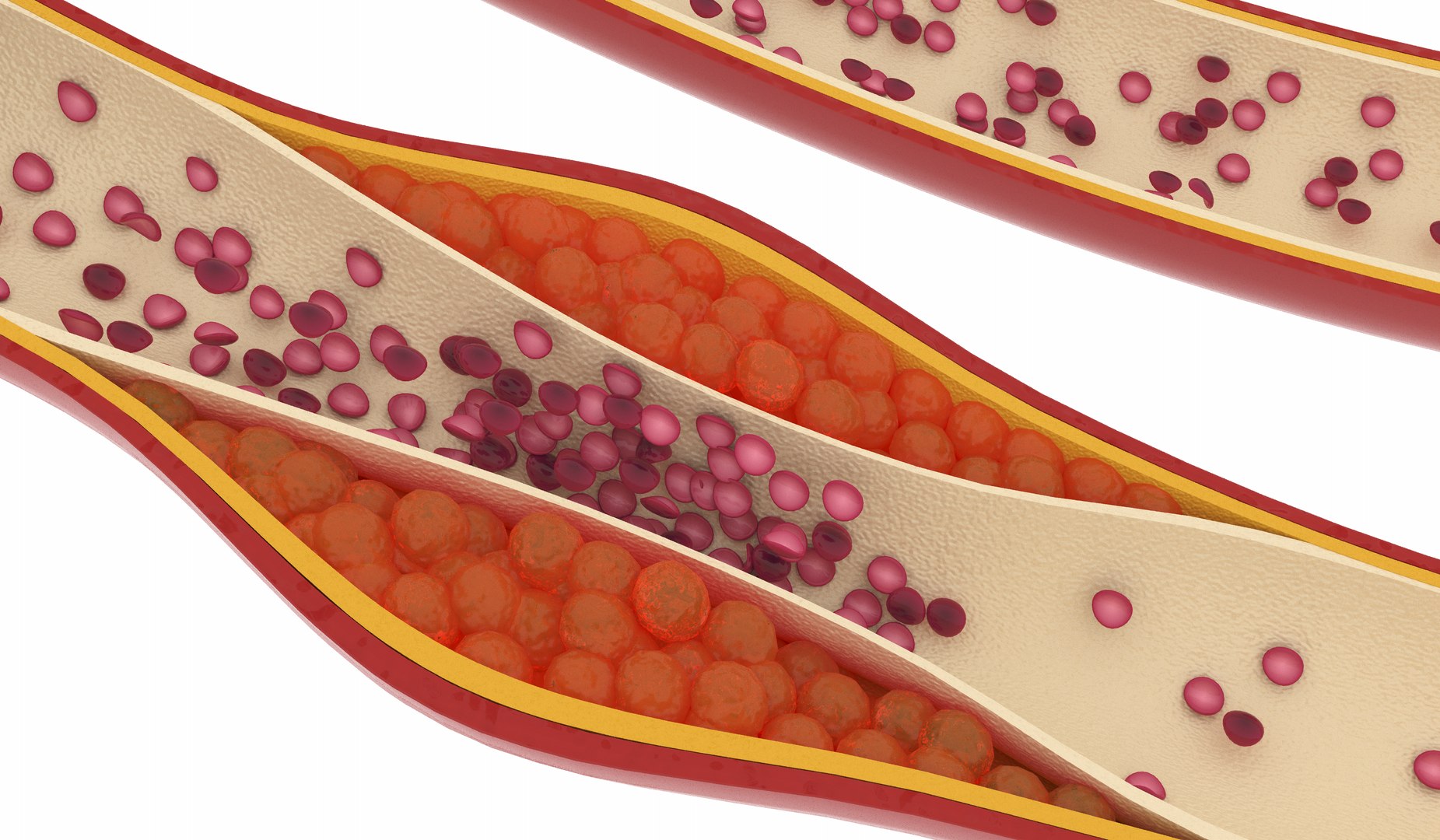 3D Model Blood Vessel Normal Damages - TurboSquid 1243108