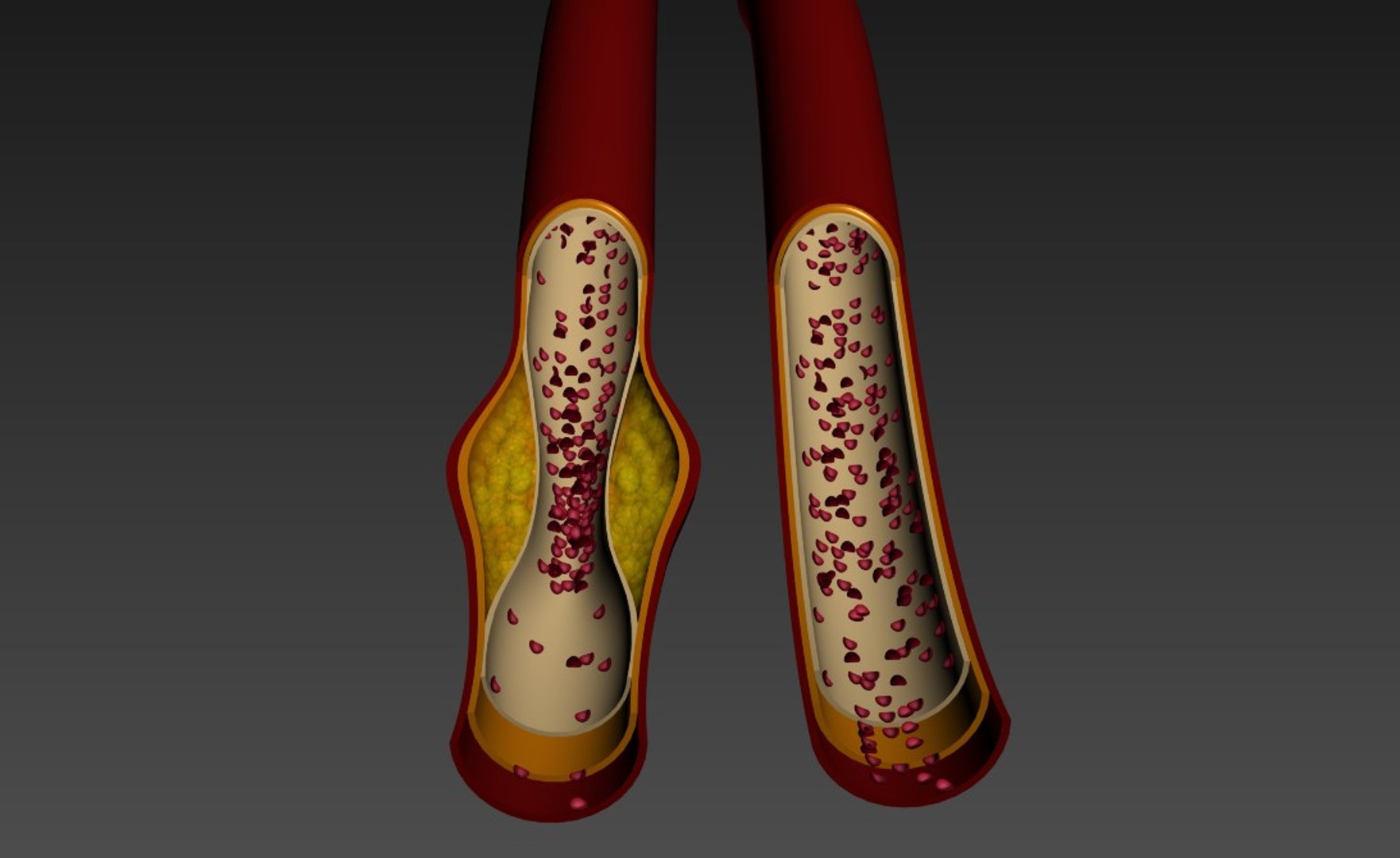 3D Model Blood Vessel Normal Damages - TurboSquid 1243108