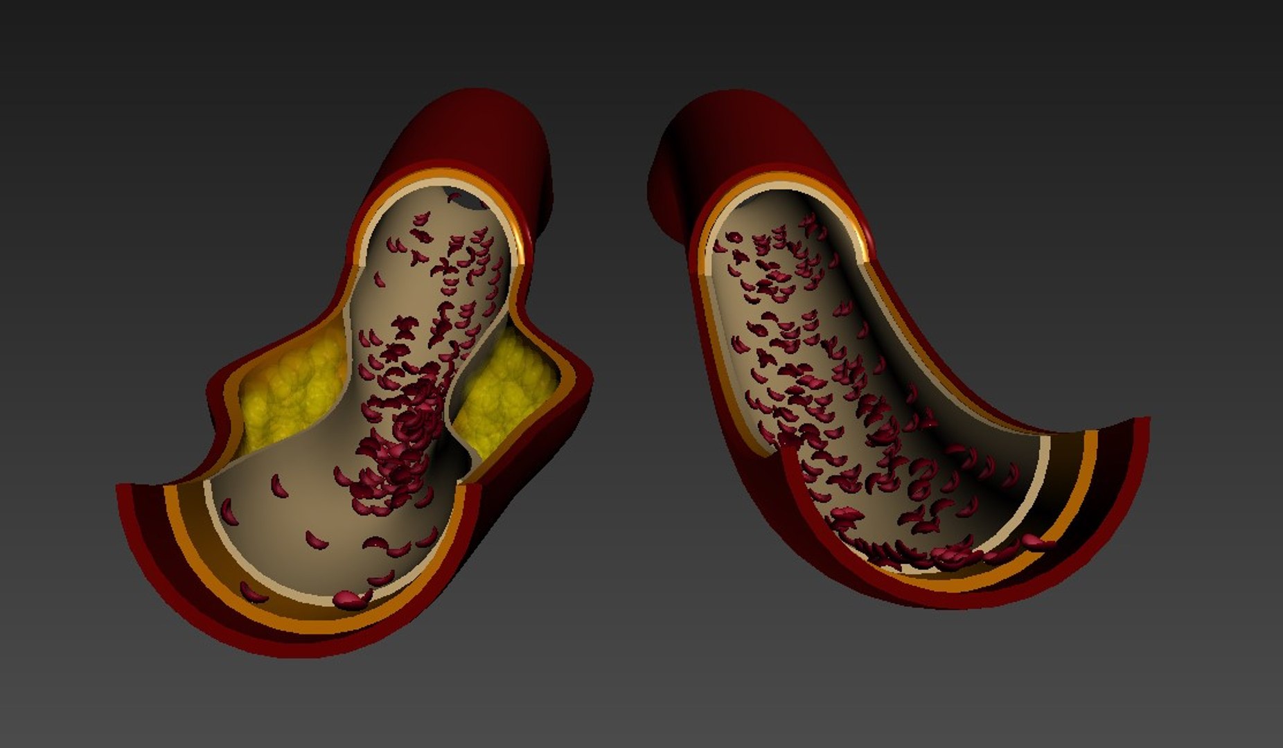 3D Model Blood Vessel Normal Damages - TurboSquid 1243108
