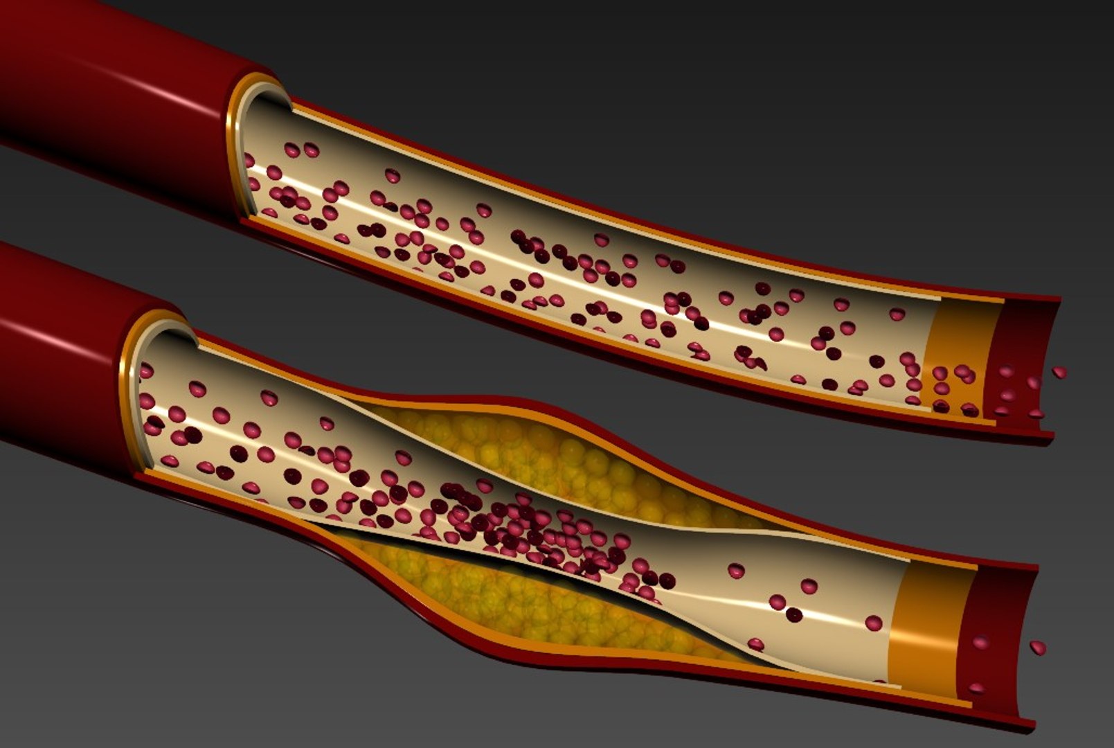 3D Model Blood Vessel Normal Damages - TurboSquid 1243108