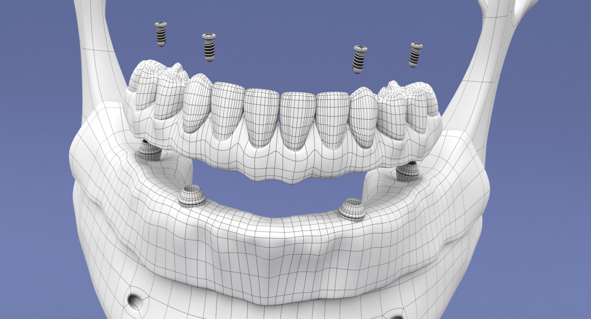 3D Denture Dental Implants - TurboSquid 1403934