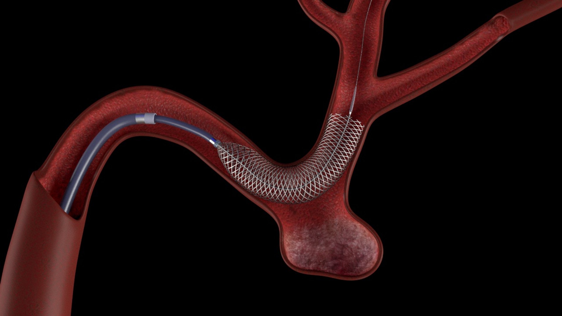 Flow Diverter Aneurysms Model - TurboSquid 1406109