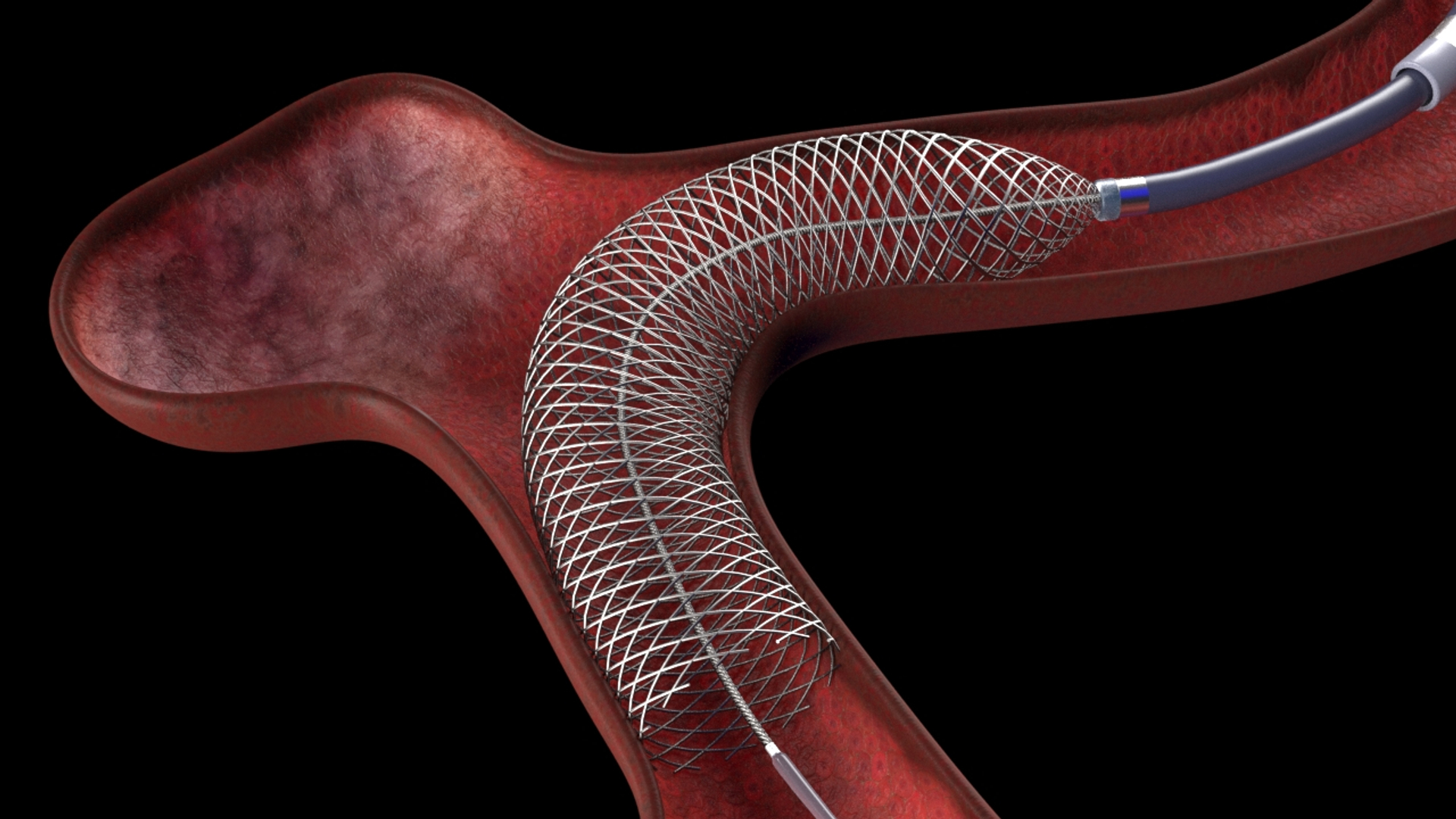 Flow Diverter Aneurysms Model - TurboSquid 1406109