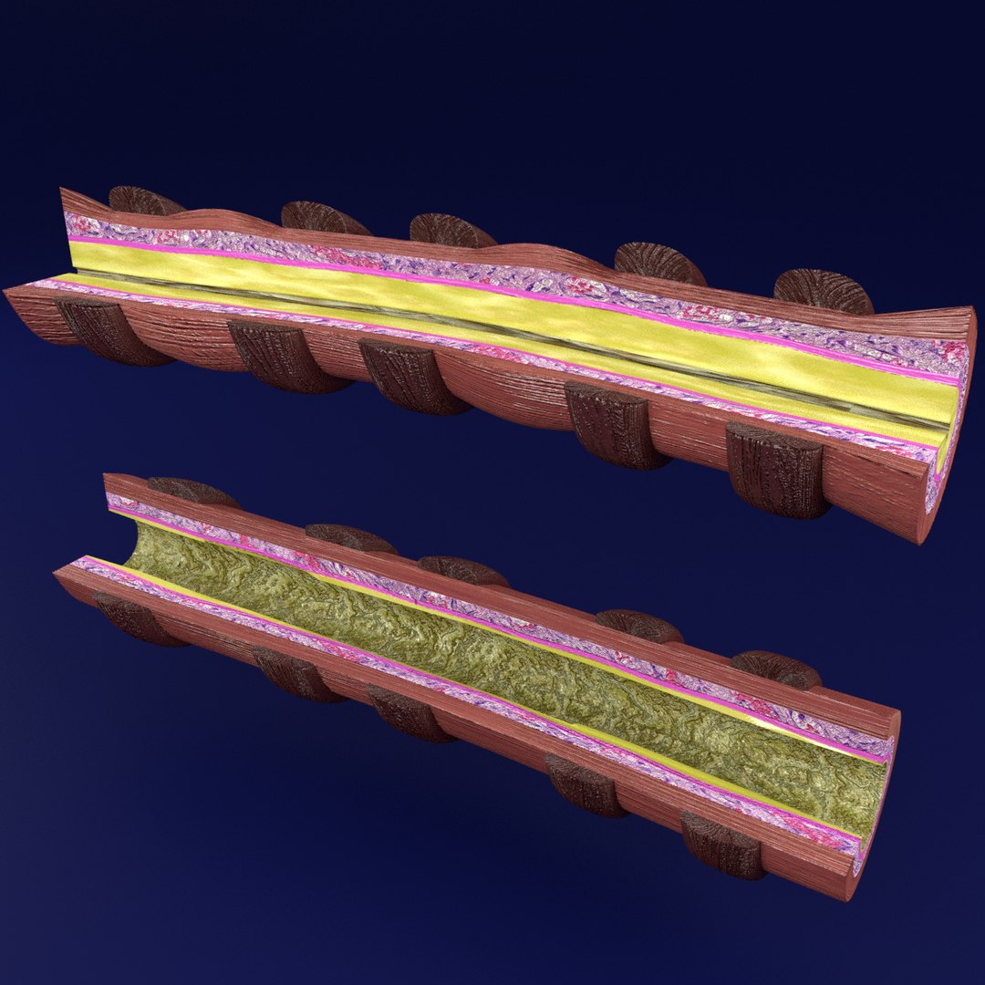 3D Bronchioles Asthma Model - TurboSquid 1480041