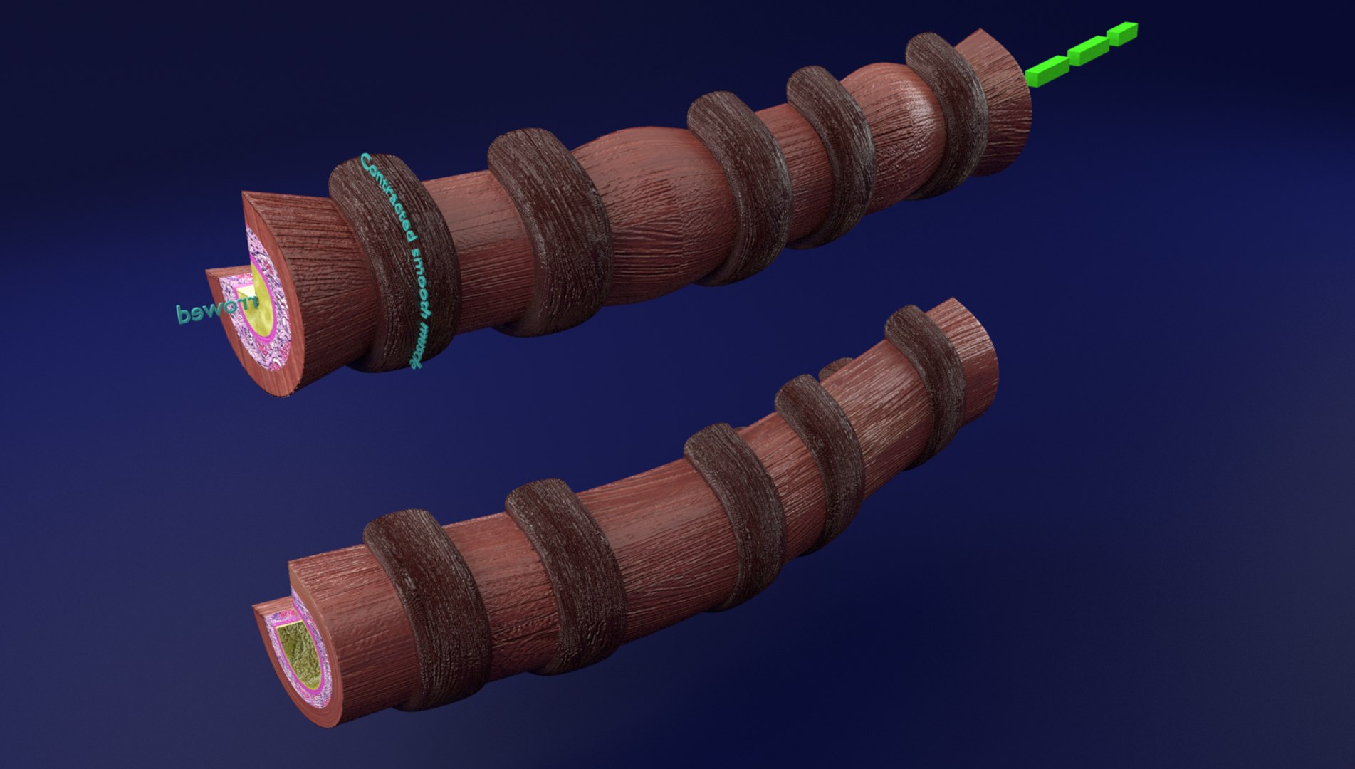 3D Bronchioles Asthma Model - TurboSquid 1480041