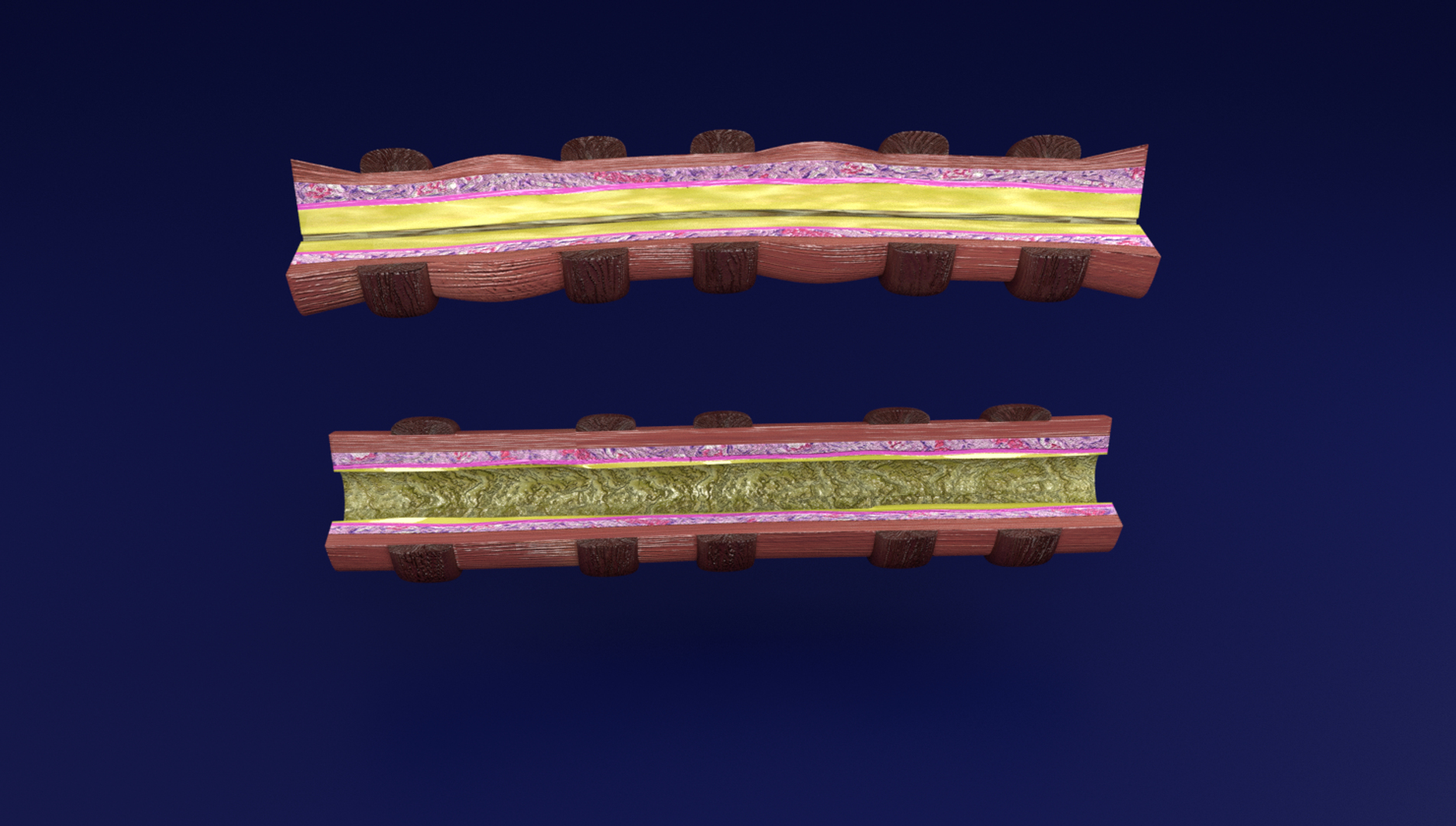 3D Bronchioles Asthma Model - TurboSquid 1480041