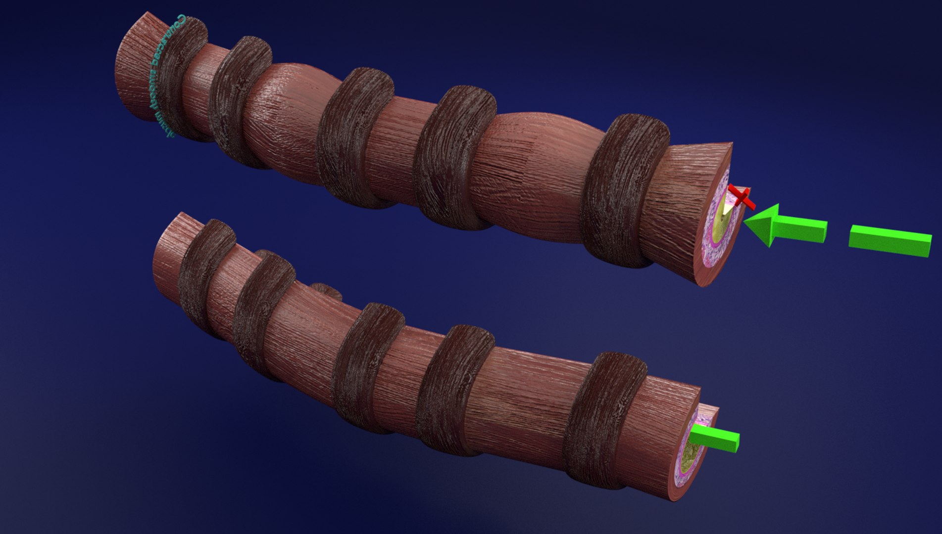3D Bronchioles Asthma Model - TurboSquid 1480041