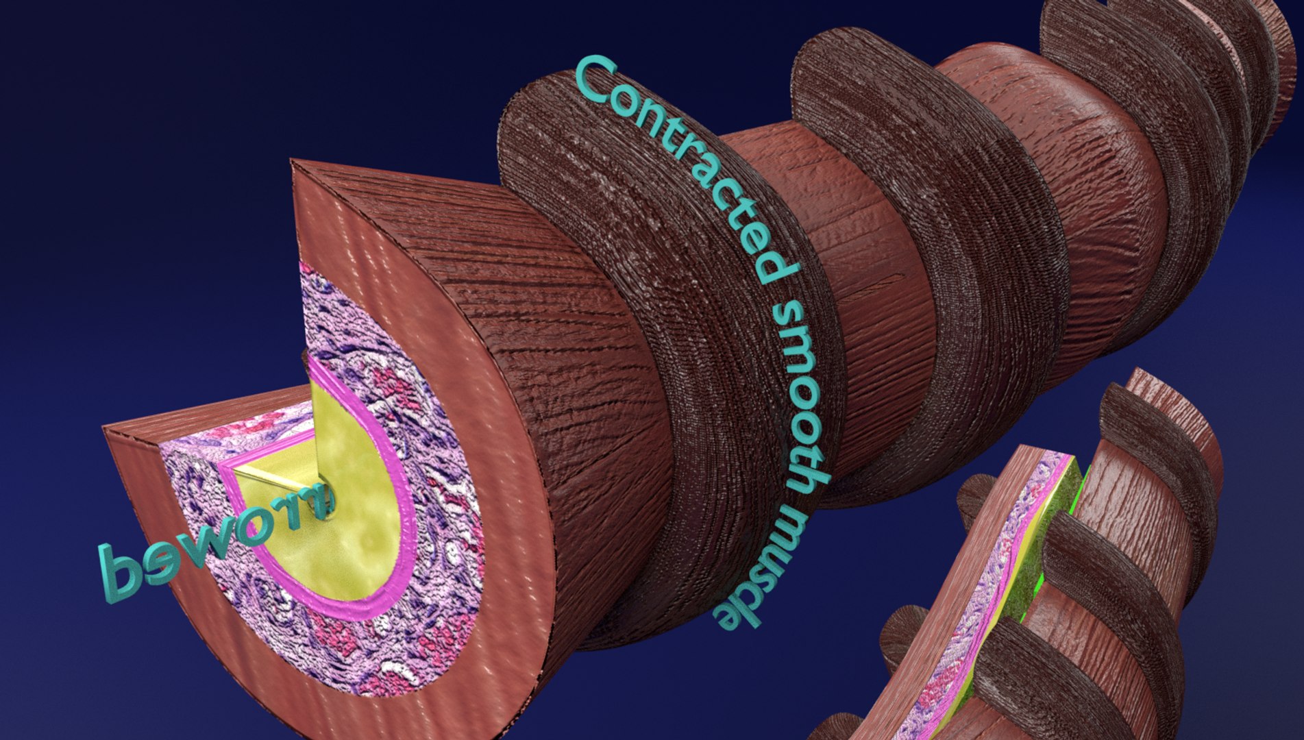 3D Bronchioles Asthma Model - TurboSquid 1480041