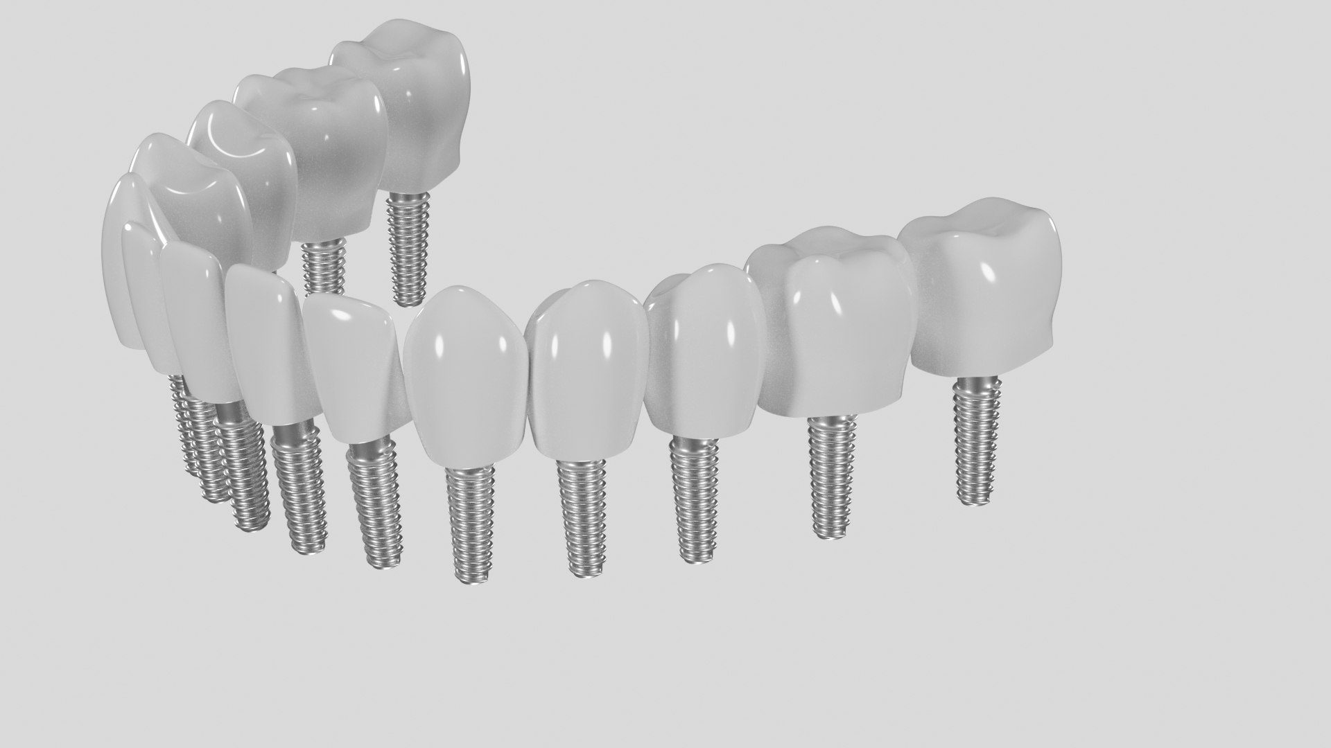 3D Dental Implant Model - TurboSquid 1722881