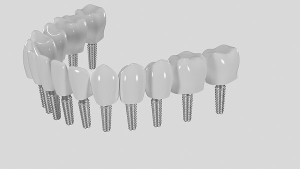 3D Dental implant model - TurboSquid 1722881